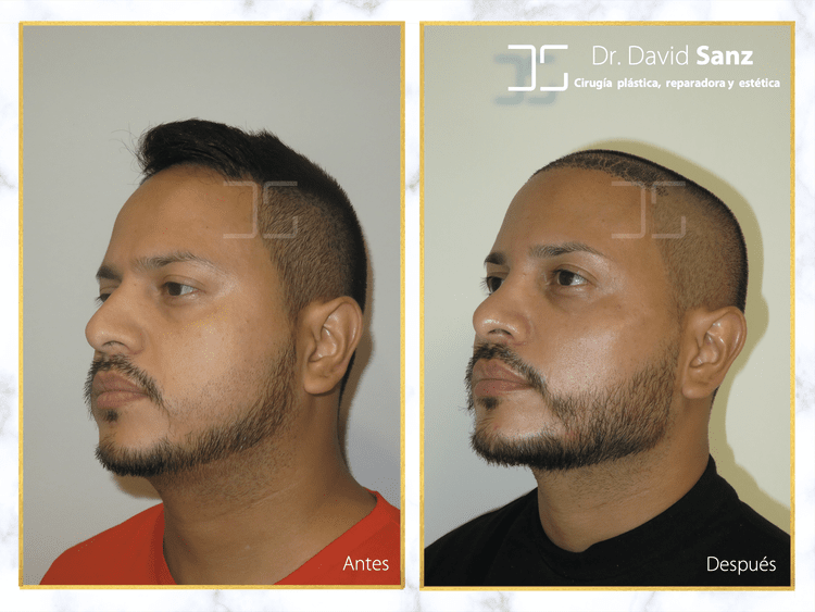 Marcación mandibular | Cirugía plástica en Barcelona — DSculpt Clinic