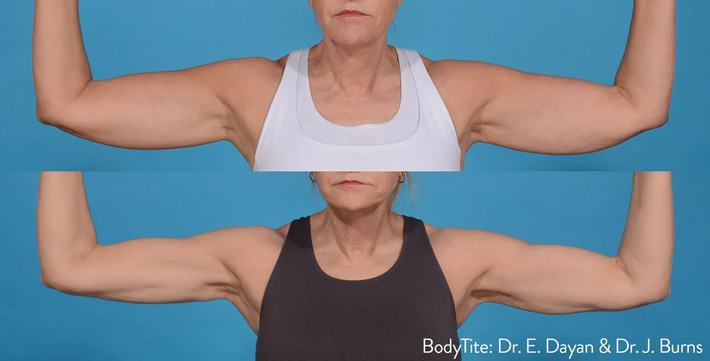 BodyTite brazos | Cirugía plástica en Barcelona — DSculpt Clinic