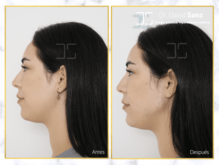Marcación mandibular | Cirugía plástica en Barcelona — DSculpt Clinic