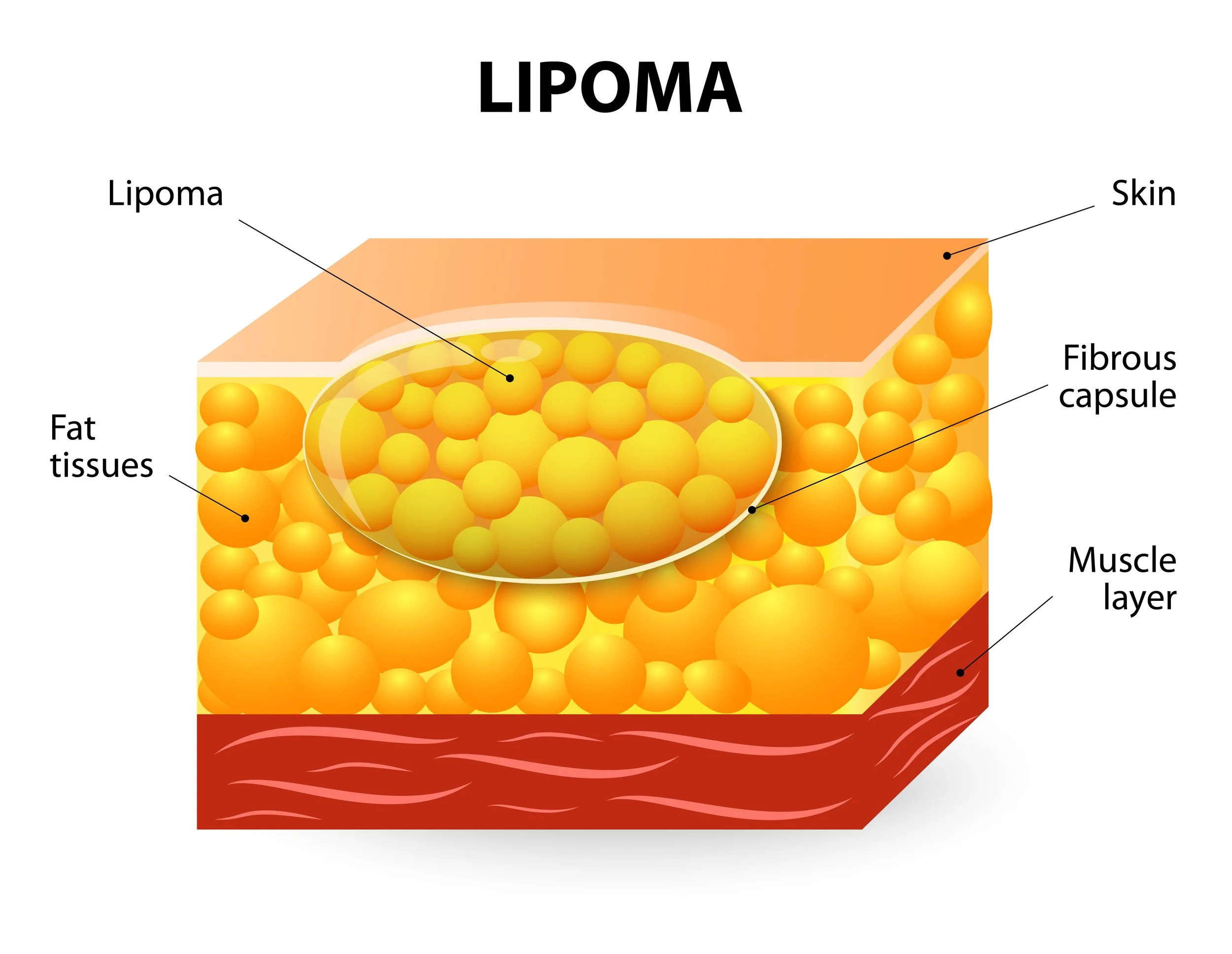 Lipomas — DSculpt Clinic