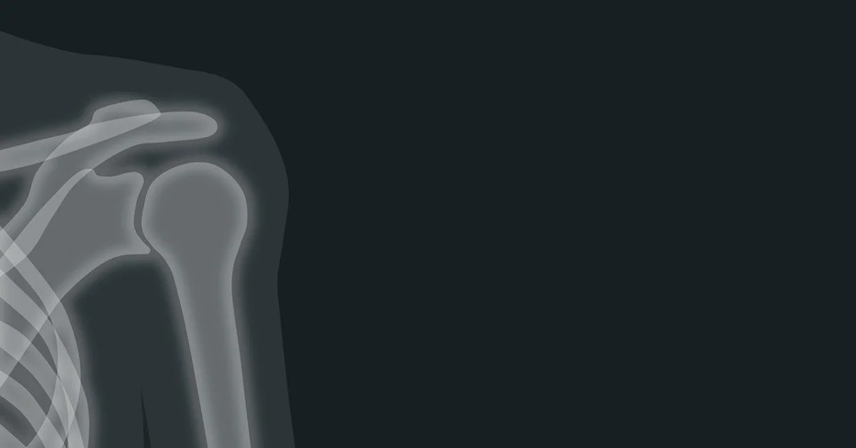Shoulder fractures and surgeries - First Line Physio