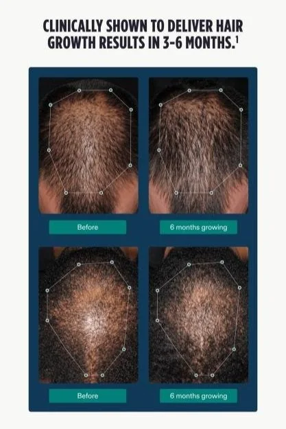 Hair Growth — Estima Aesthetics