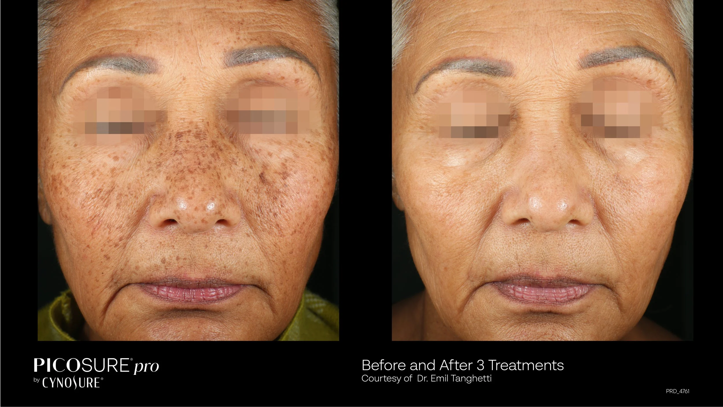 Picosure — breaks up areas of dark pigmentation in skin. Hawaii Vision Specialists, Hilo, Hawaii ...
