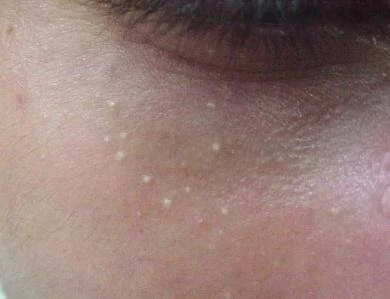 How To Determine and Treat Different Types of Acne