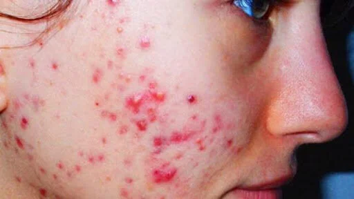 How To Determine and Treat Different Types of Acne