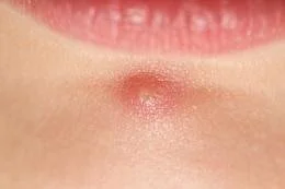 How To Determine and Treat Different Types of Acne