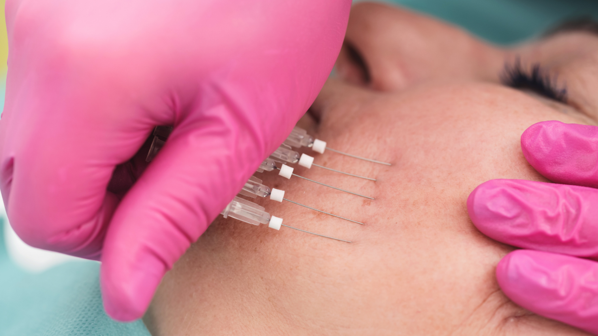 PDO Thread Lift In Aspen, CO | The NeuroSpa