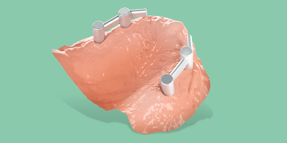 Klikprothese — De Denticien