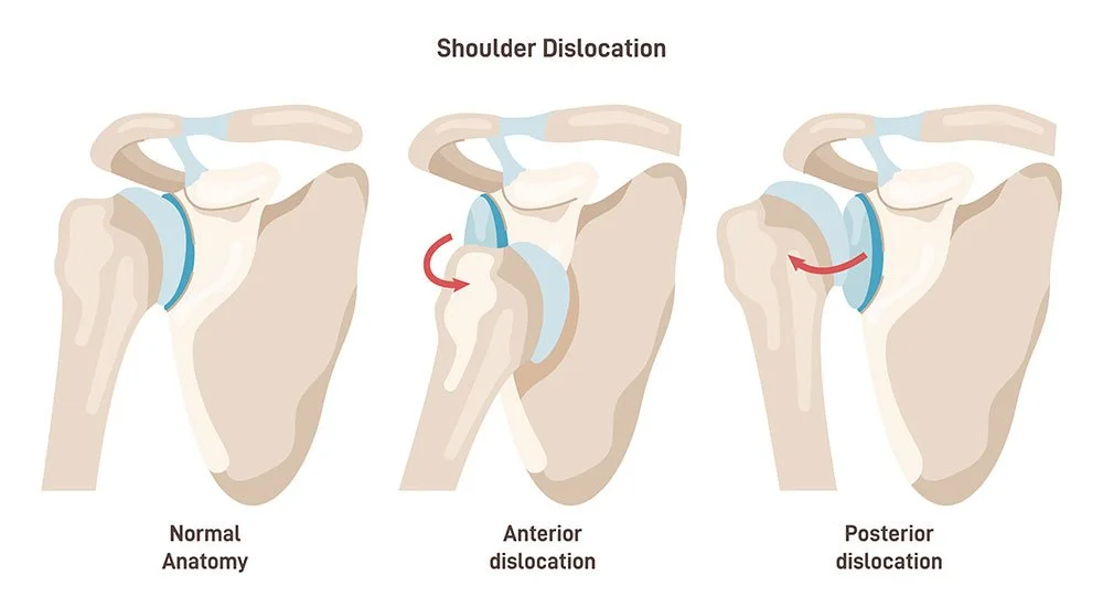 Is Shoulder Popping Normal? | Why is my Shoulder Popping? | Shoulder ...