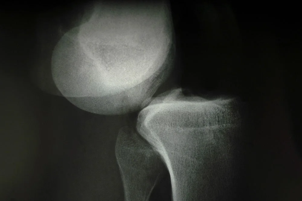 Can Knee Dislocation Cause Arthritis? | Did I Dislocate My Knee? | Knee ...