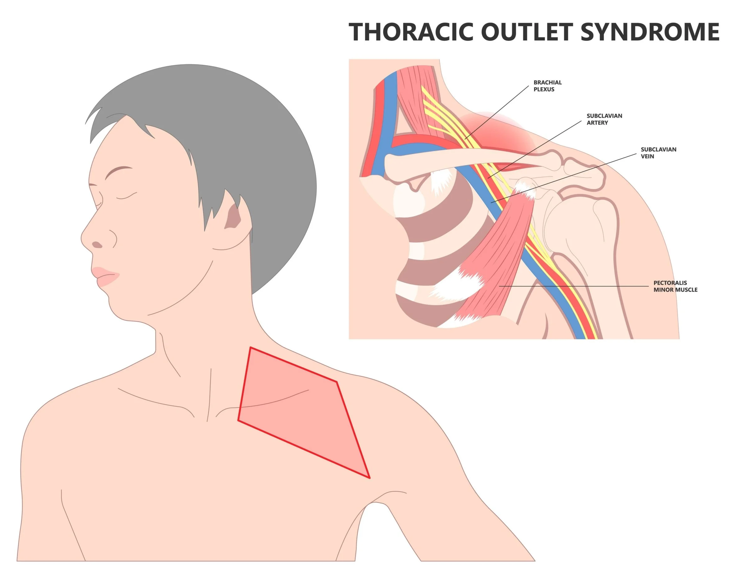 Pilates for hypermobility, hEDS and Ehlers Danlos Syndrome