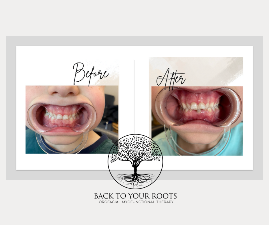 Back To Your Roots Orofacial Myofunctional Therapy/Kelly-Hall-RDH-OMT ...