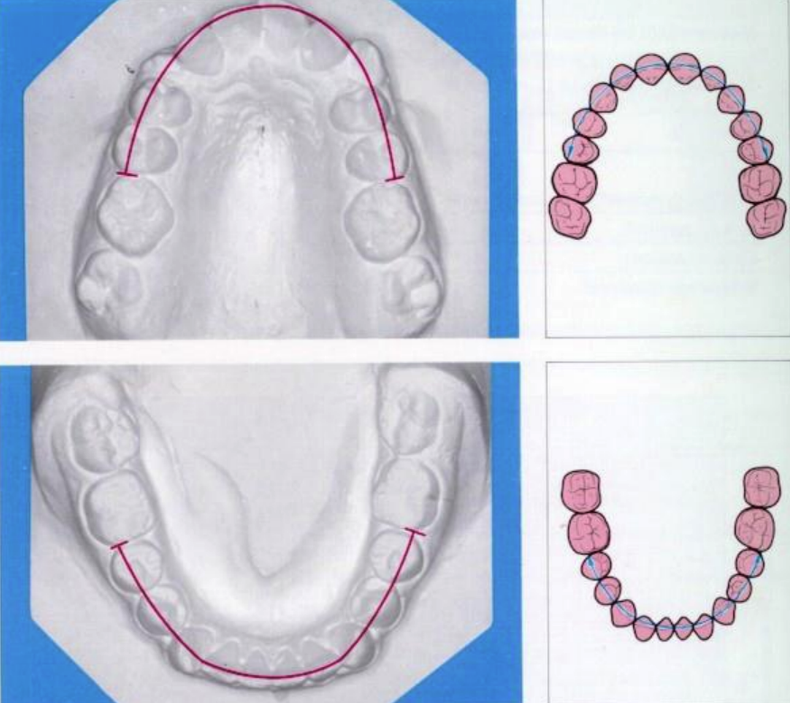 Optimal Orthodontic: Space Analysis & Tooth Size Discrepancy ...