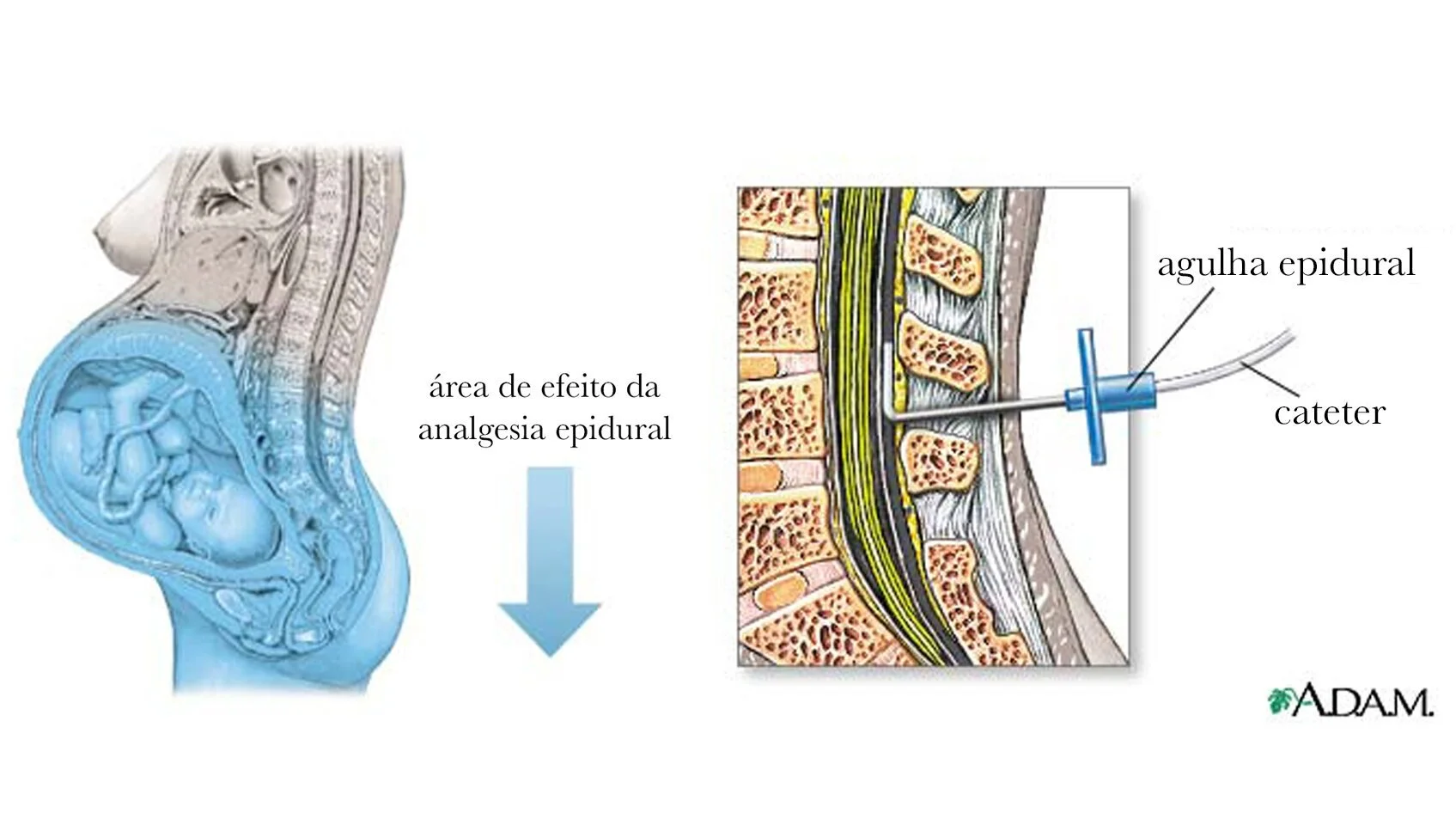 Epidural Analgesia Local Anesthetic at Randall Graves blog