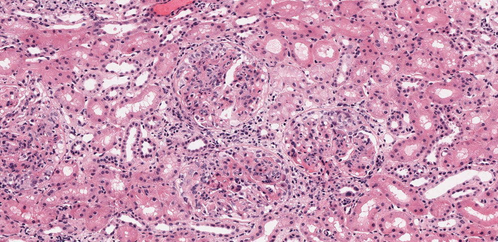 Medical Renal Pathology Lesson 2: Primary glomerular diseases ...