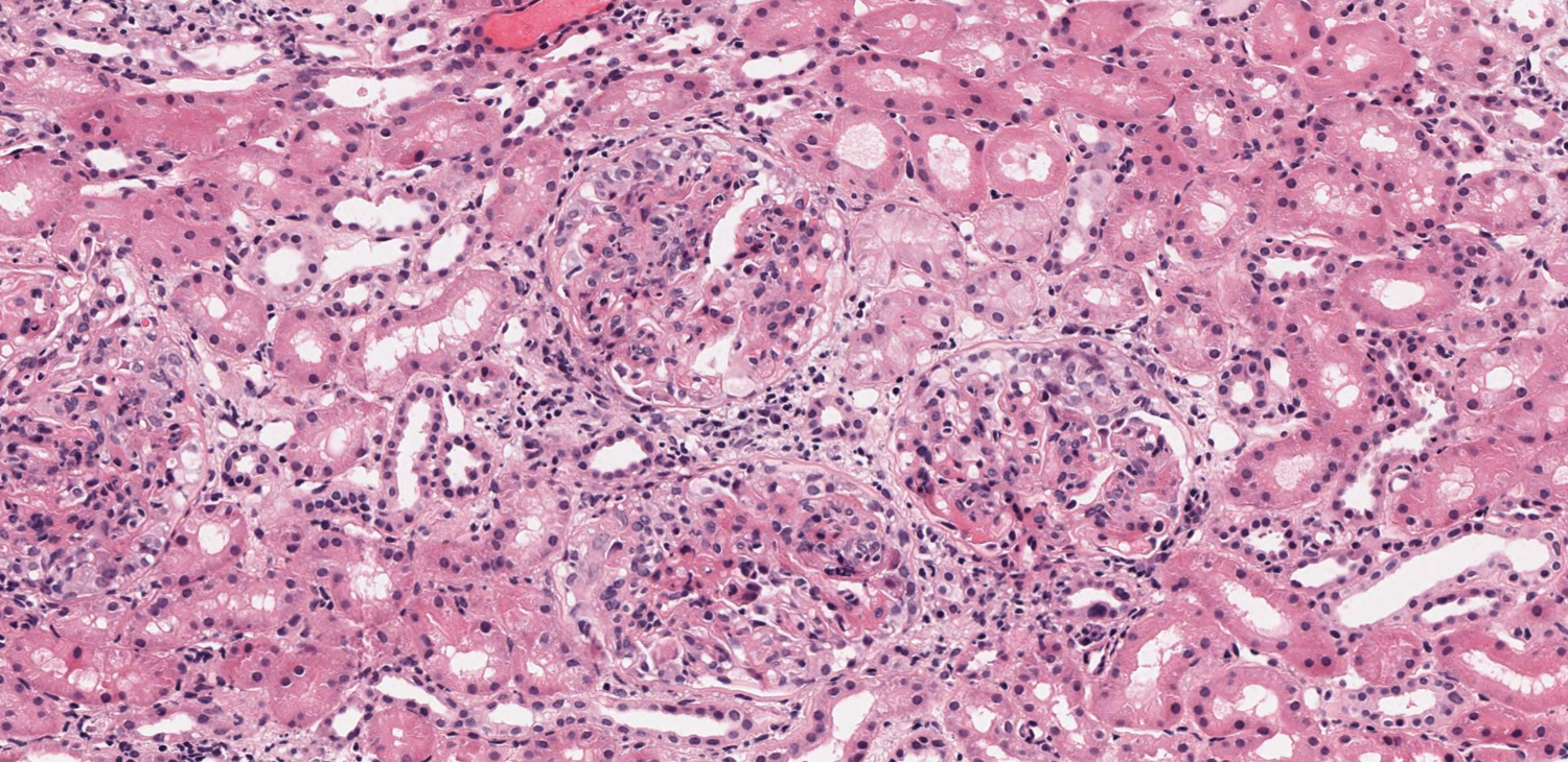 Medical Renal Pathology Lesson 2: Primary glomerular diseases — PathElective