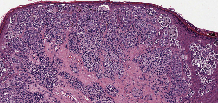 Dermatopathology Lesson 1 — PathElective