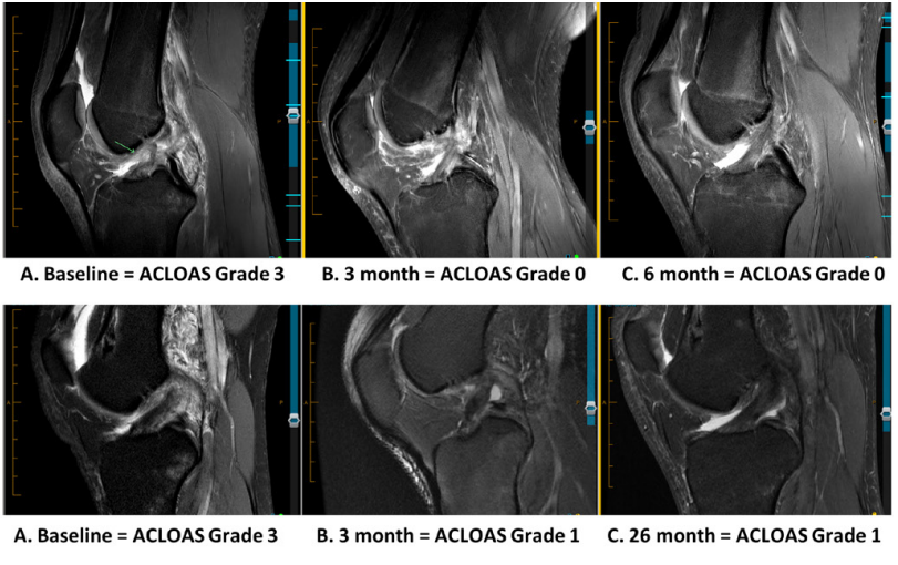 ACL Cross Bracing Protocol: Everything you need to know — The Rehab ...