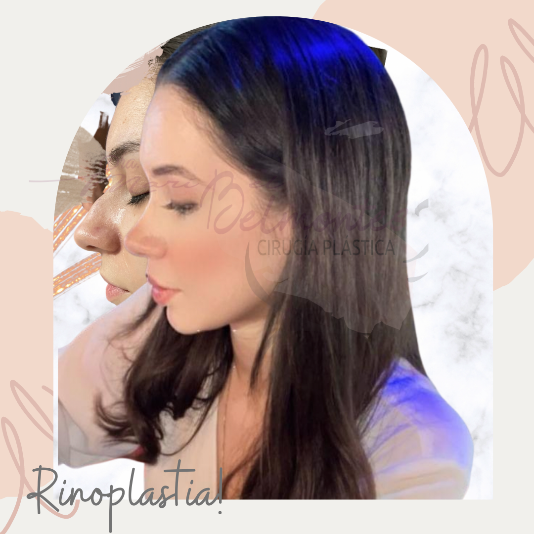 ad rinoplastia — Dra. Maribel Belmontes Castillo