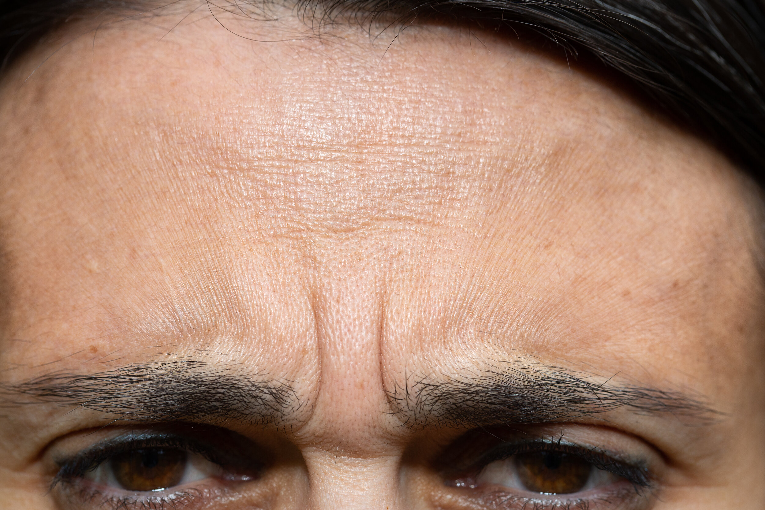 Frown Forehead Lines The McLoughlin Face Clinic