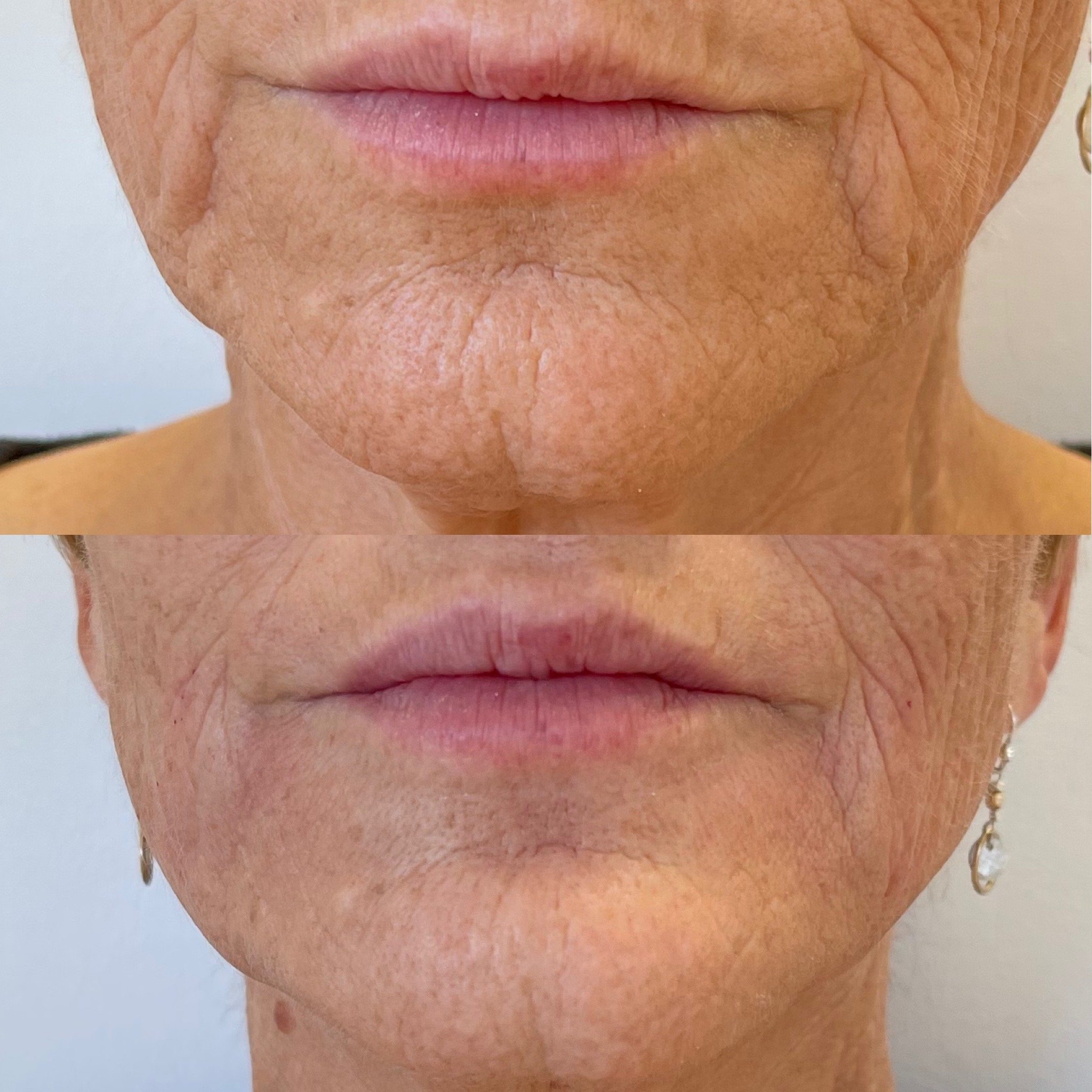 Before & Afters — Beverly Botox Nurse