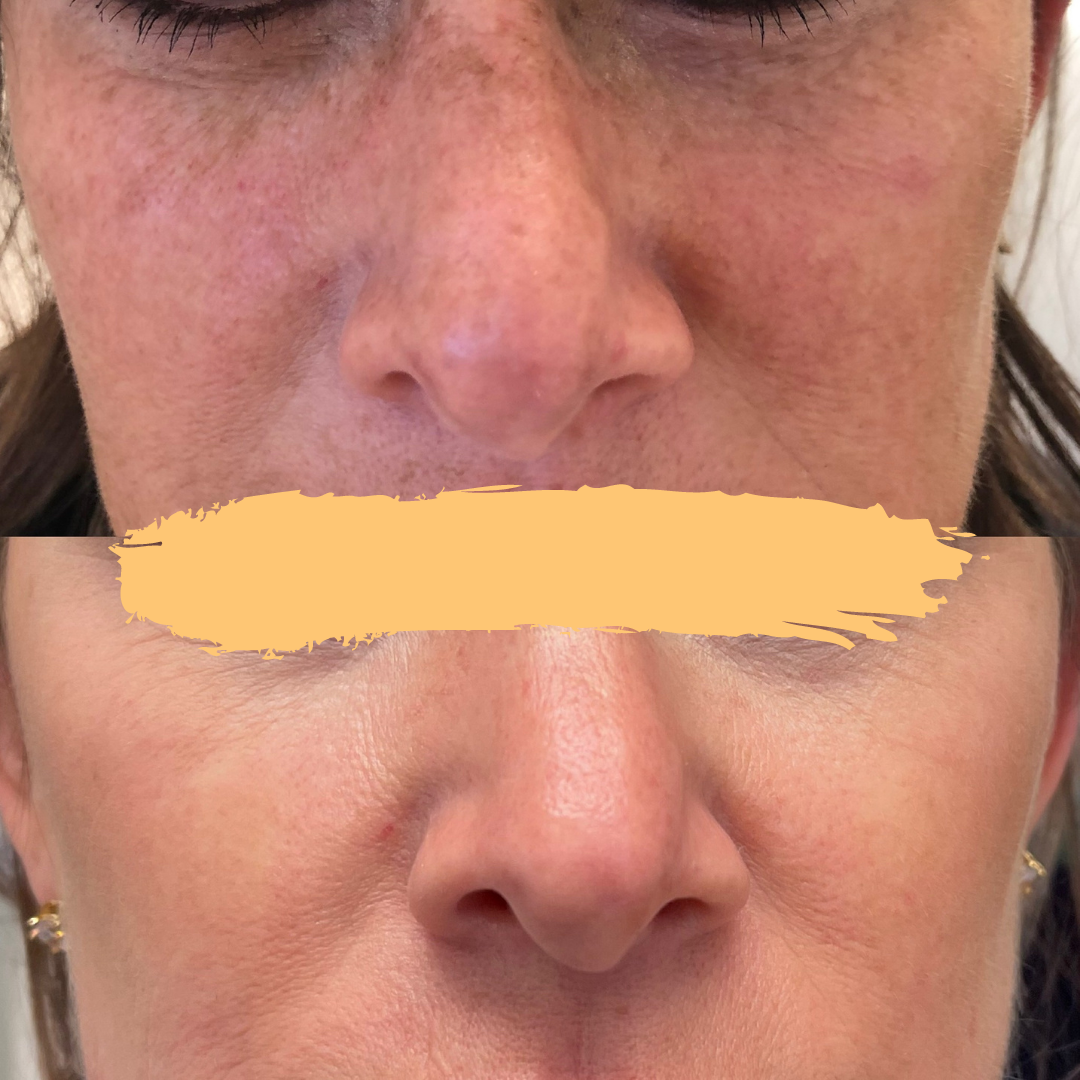 Before & Afters — Beverly Botox Nurse