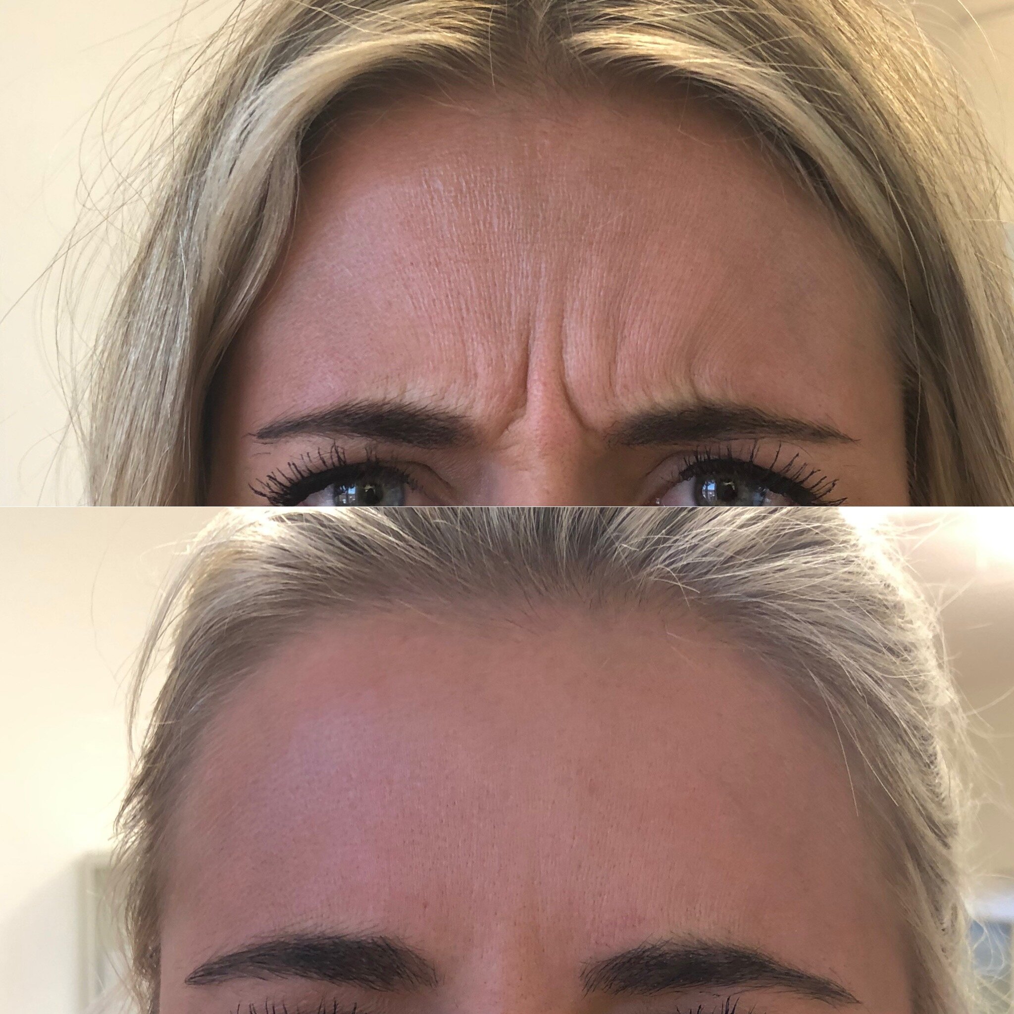 Before & Afters — Beverly Botox Nurse