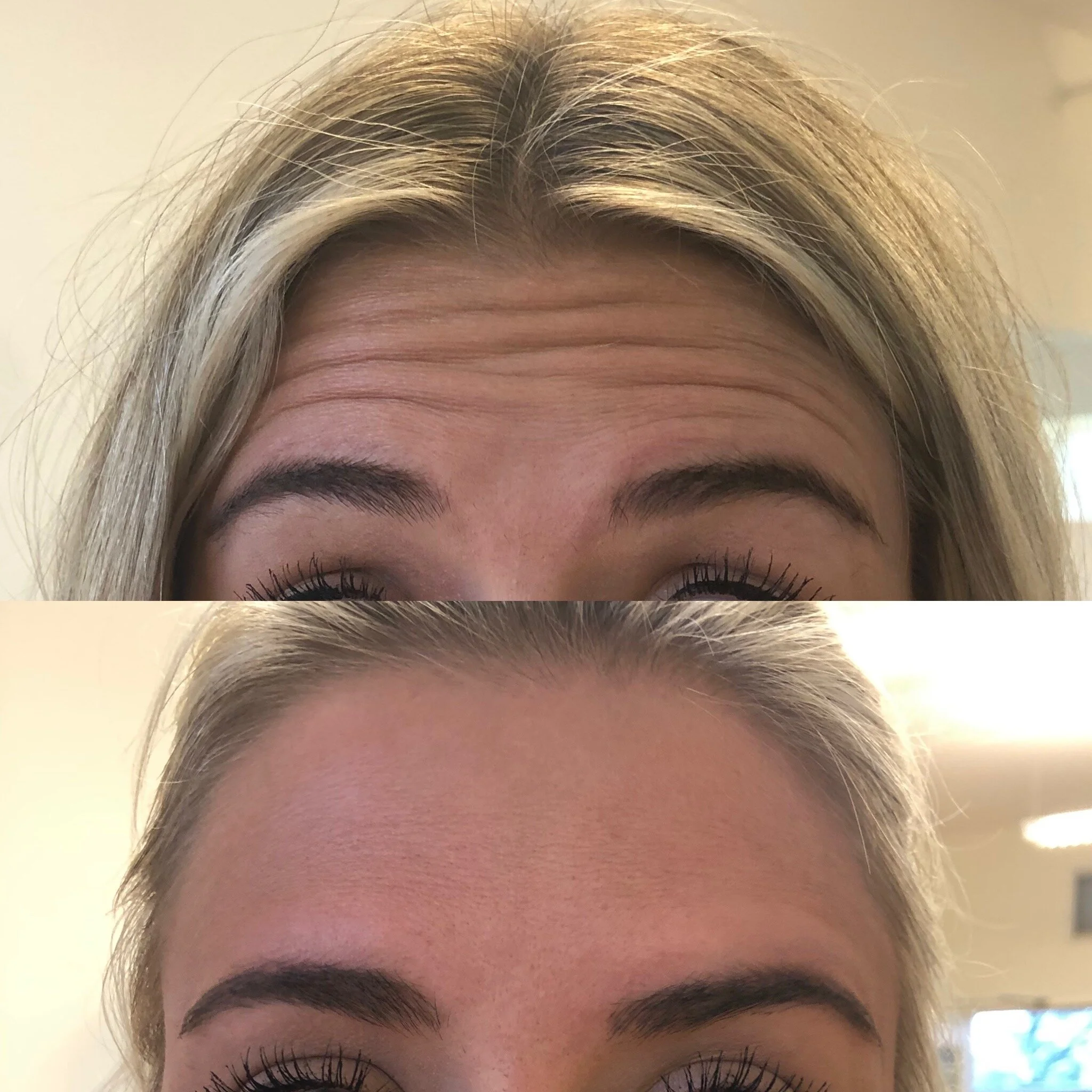 Before & Afters — Beverly Botox Nurse