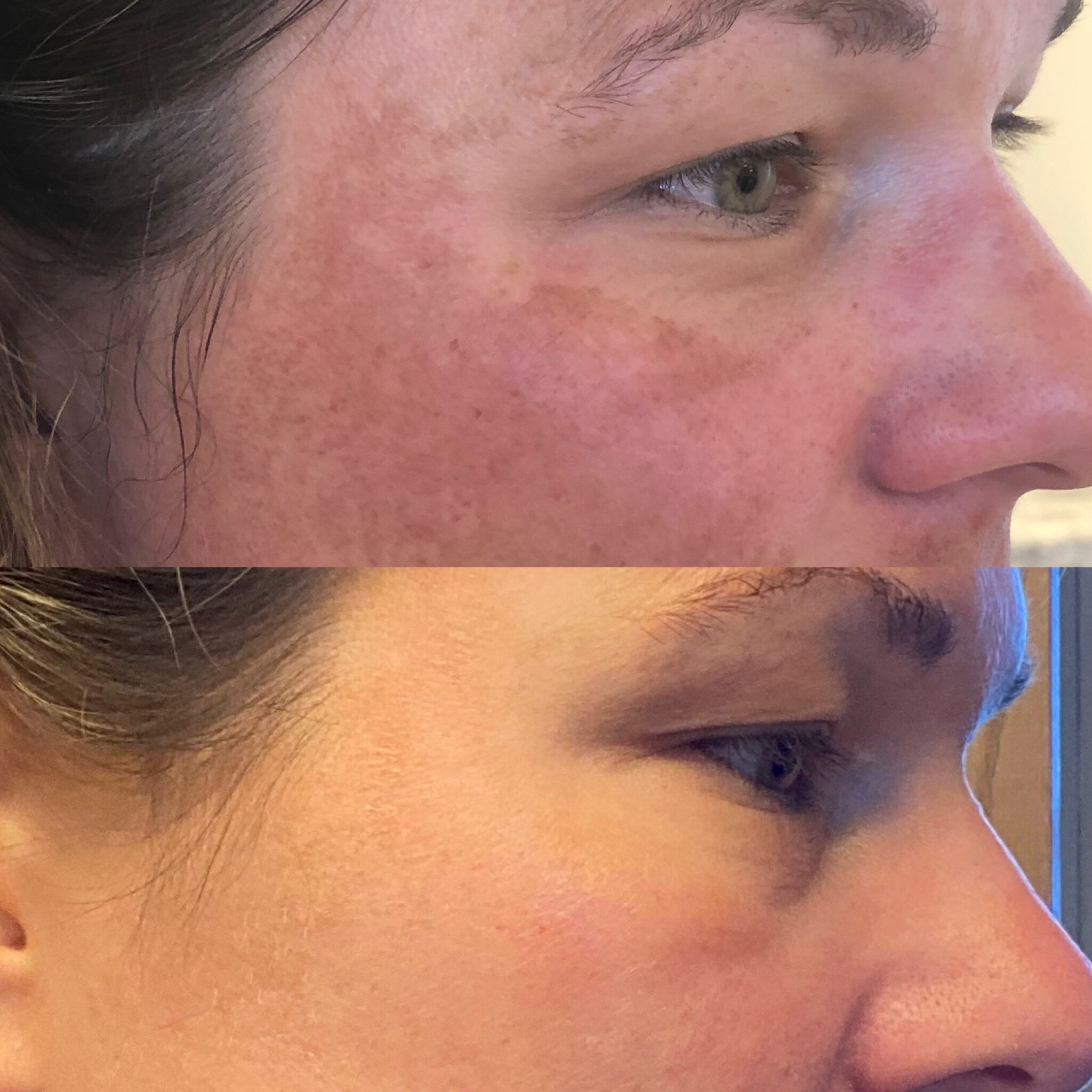 Before & Afters — Beverly Botox Nurse