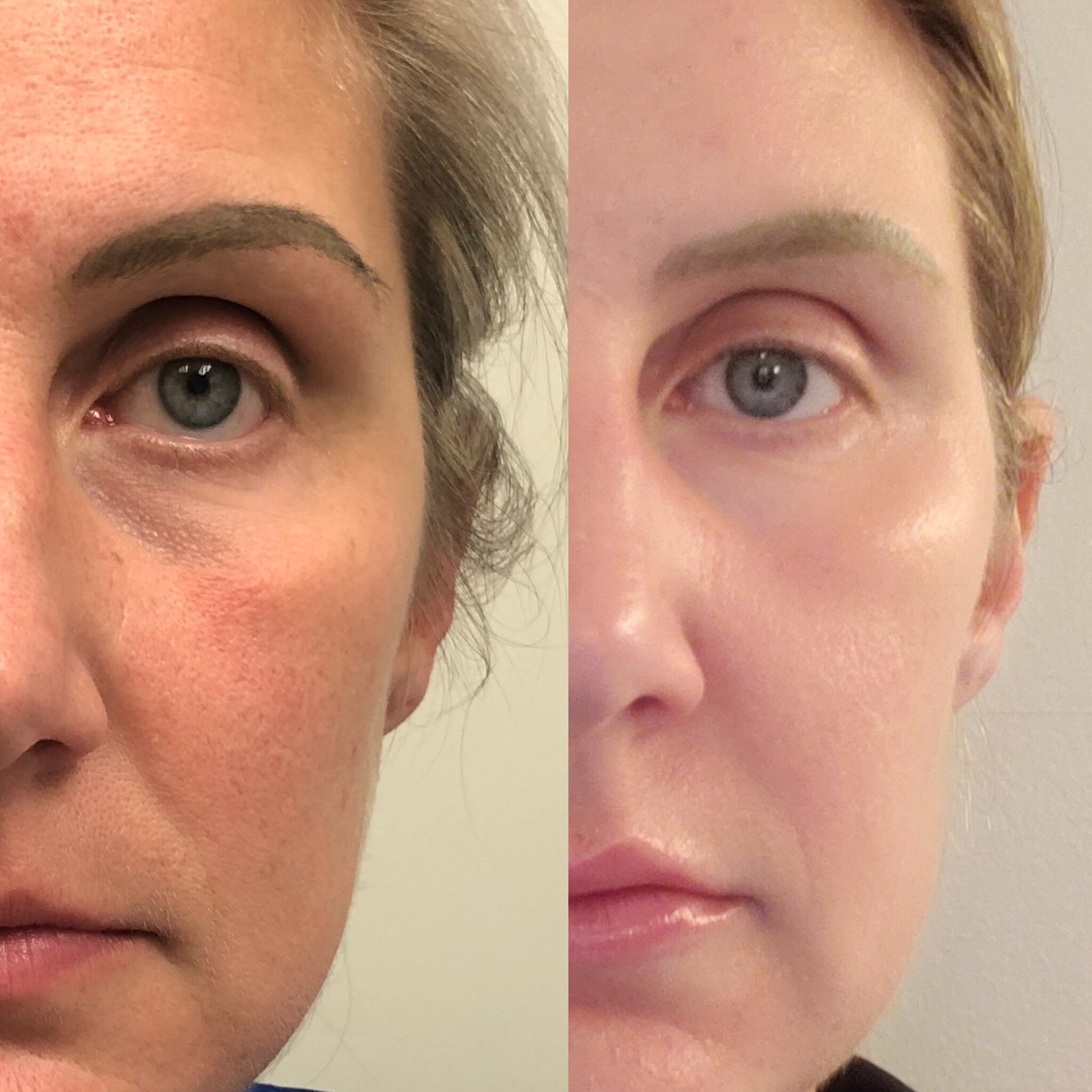 Before & Afters — Beverly Botox Nurse