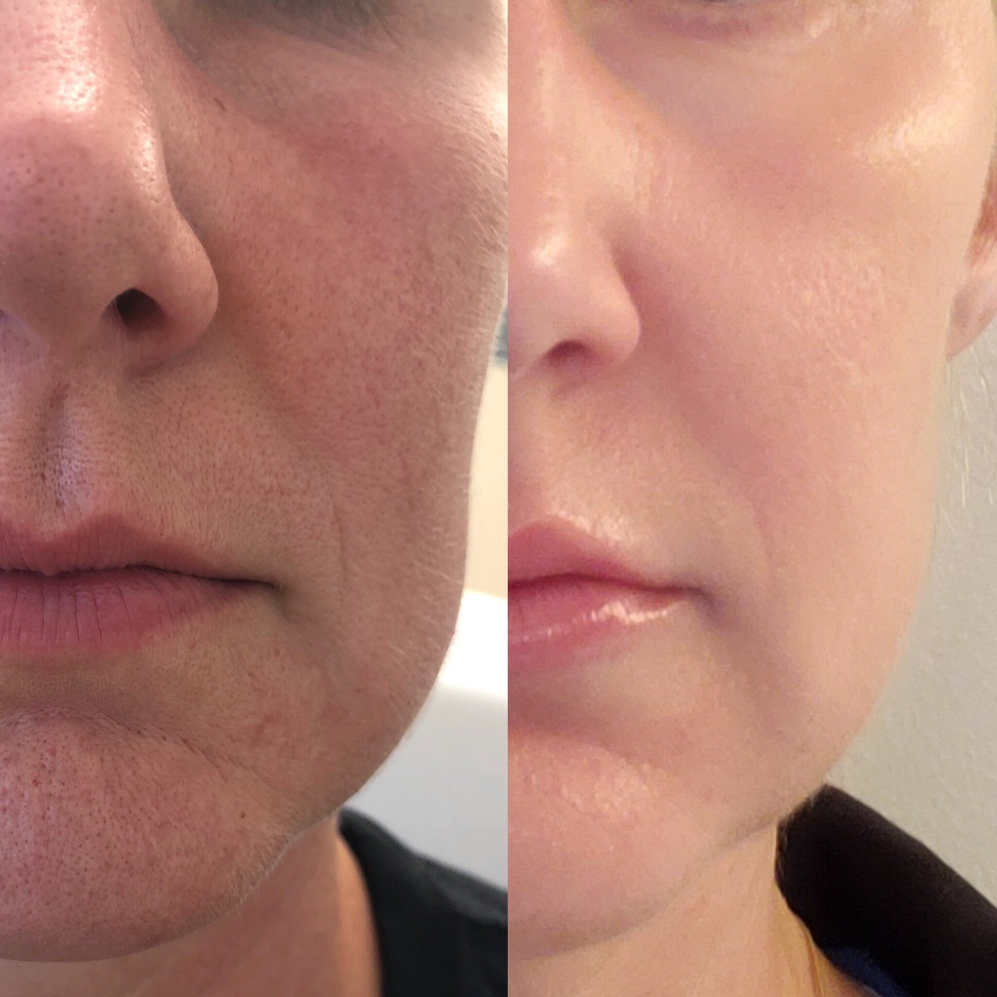 Before & Afters — Beverly Botox Nurse
