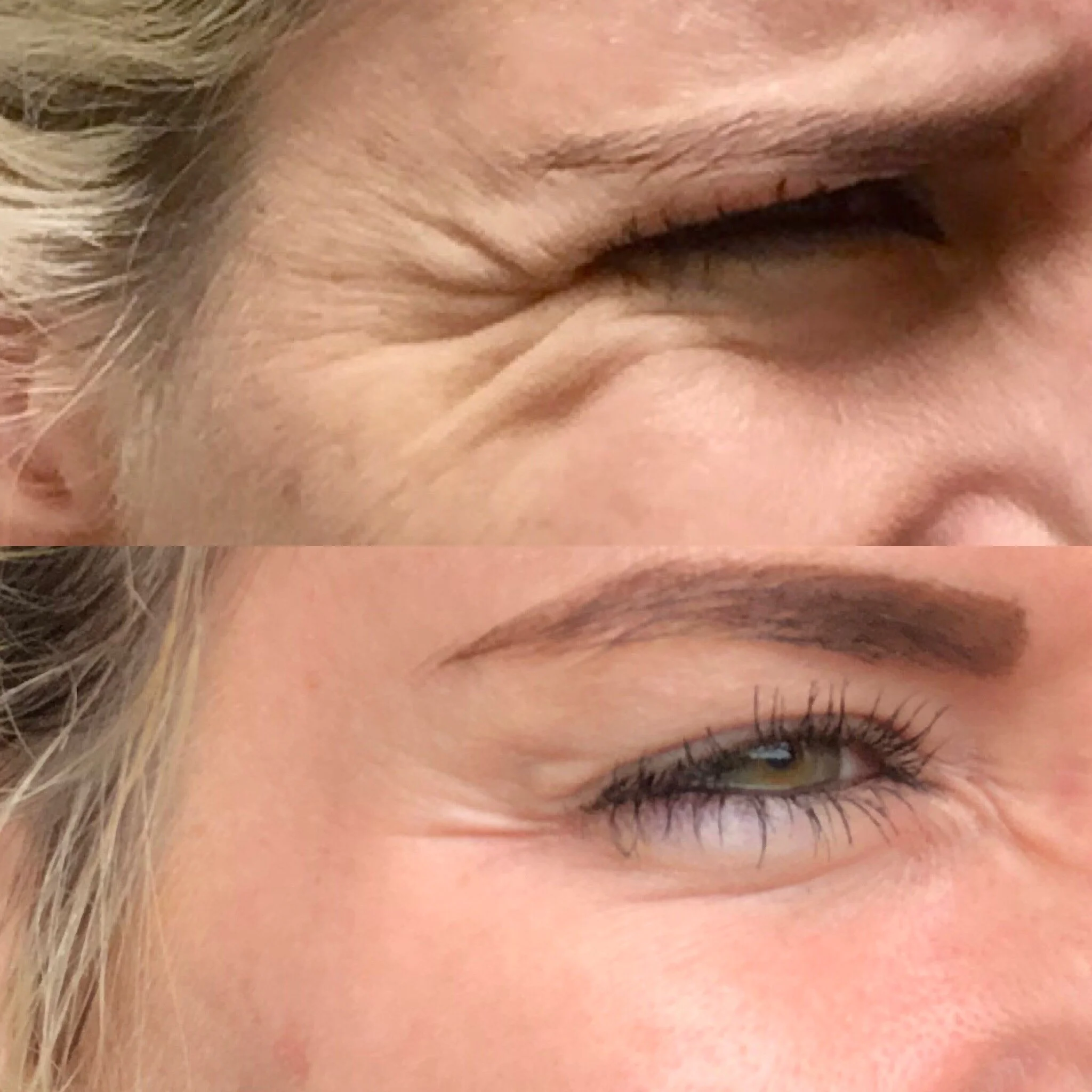 Before & Afters — Beverly Botox Nurse