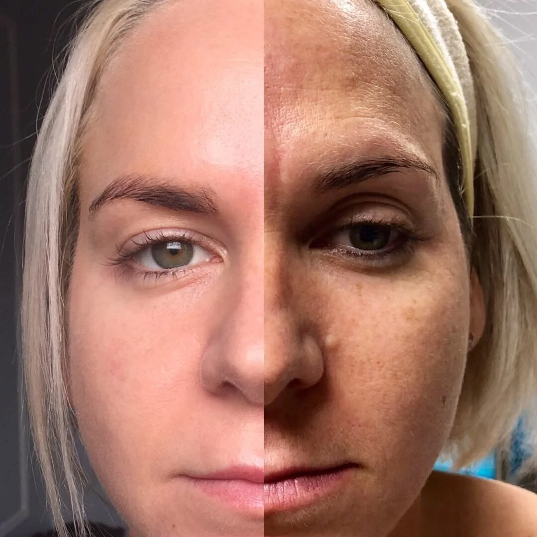 Before & Afters — Beverly Botox Nurse