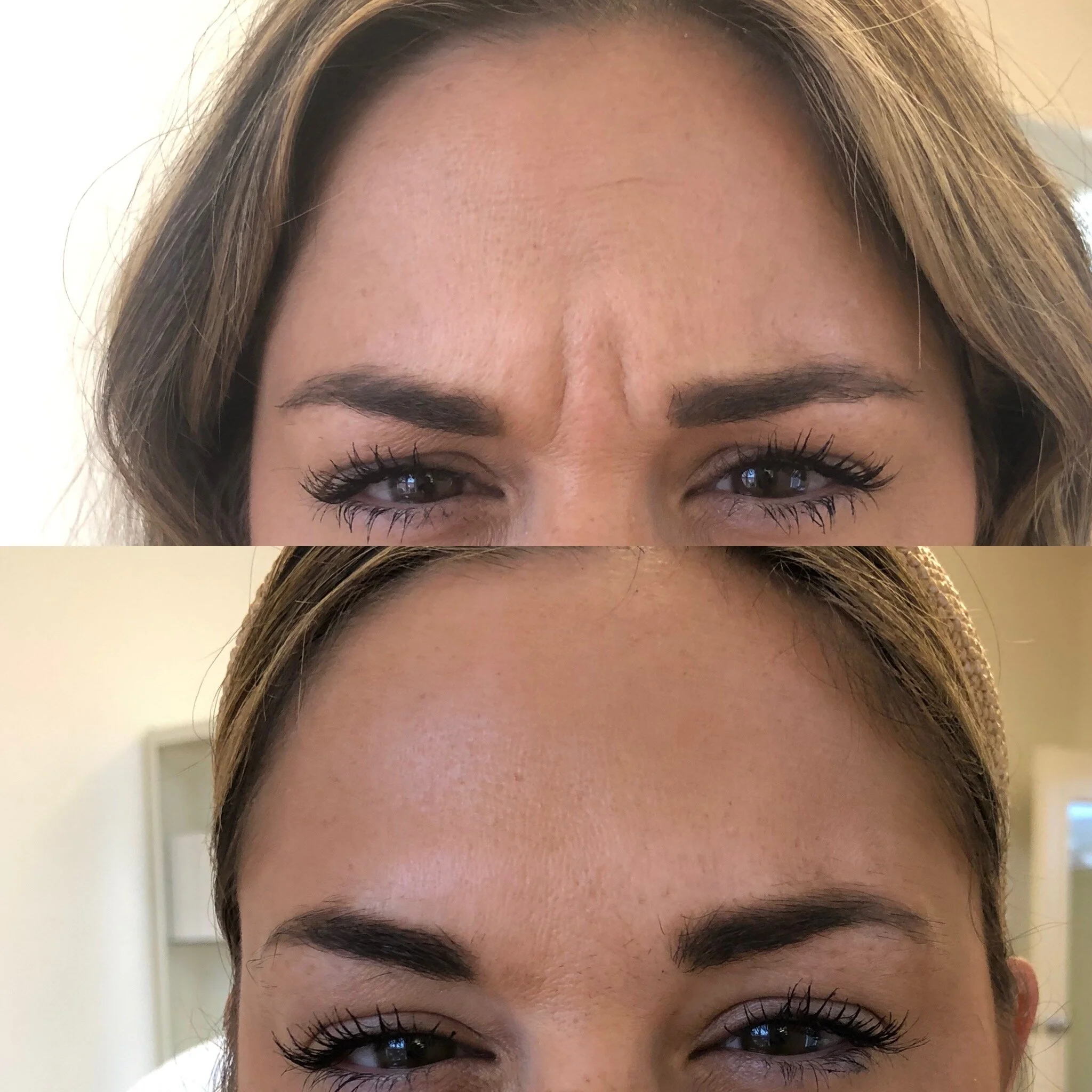 Before & Afters — Beverly Botox Nurse