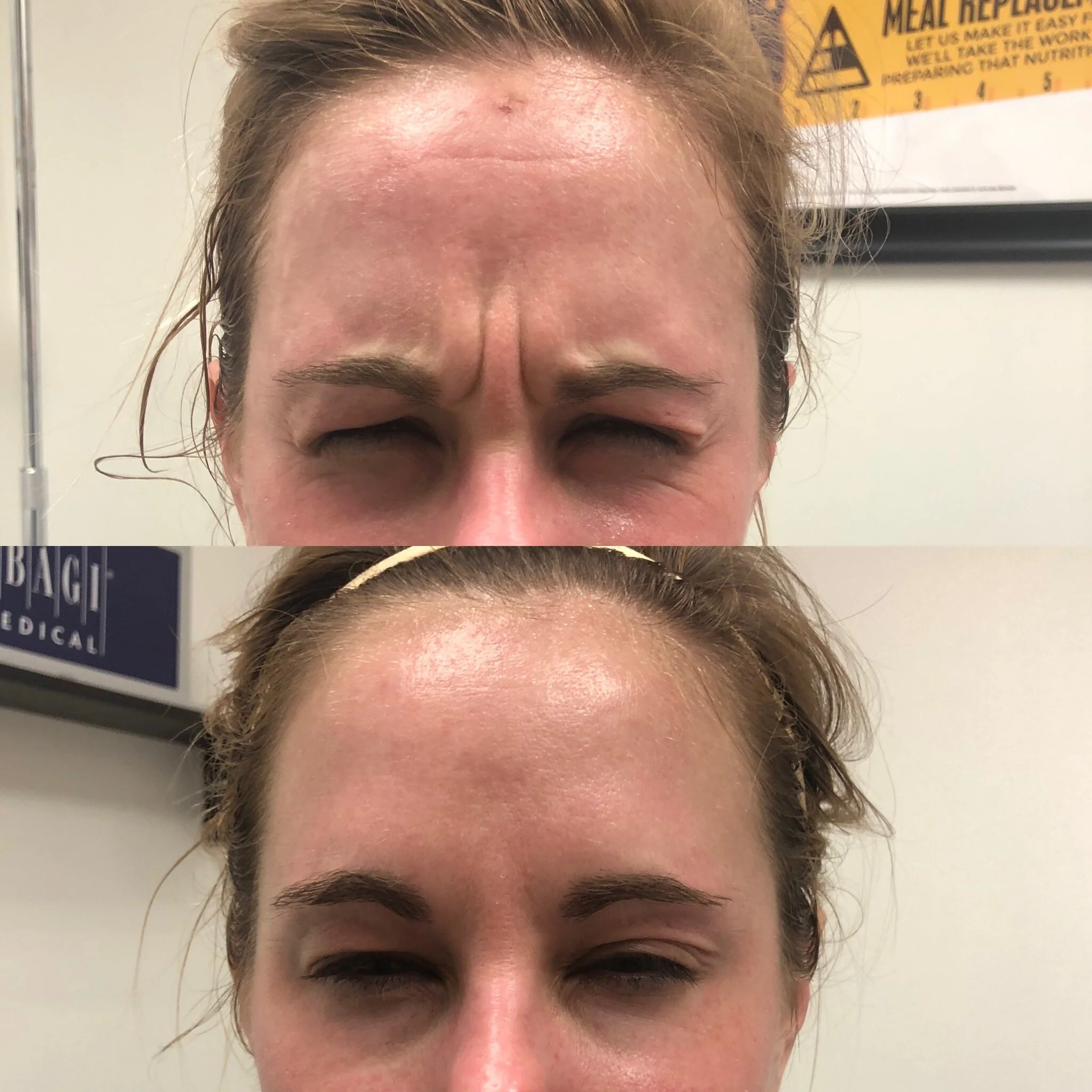 Before & Afters — Beverly Botox Nurse