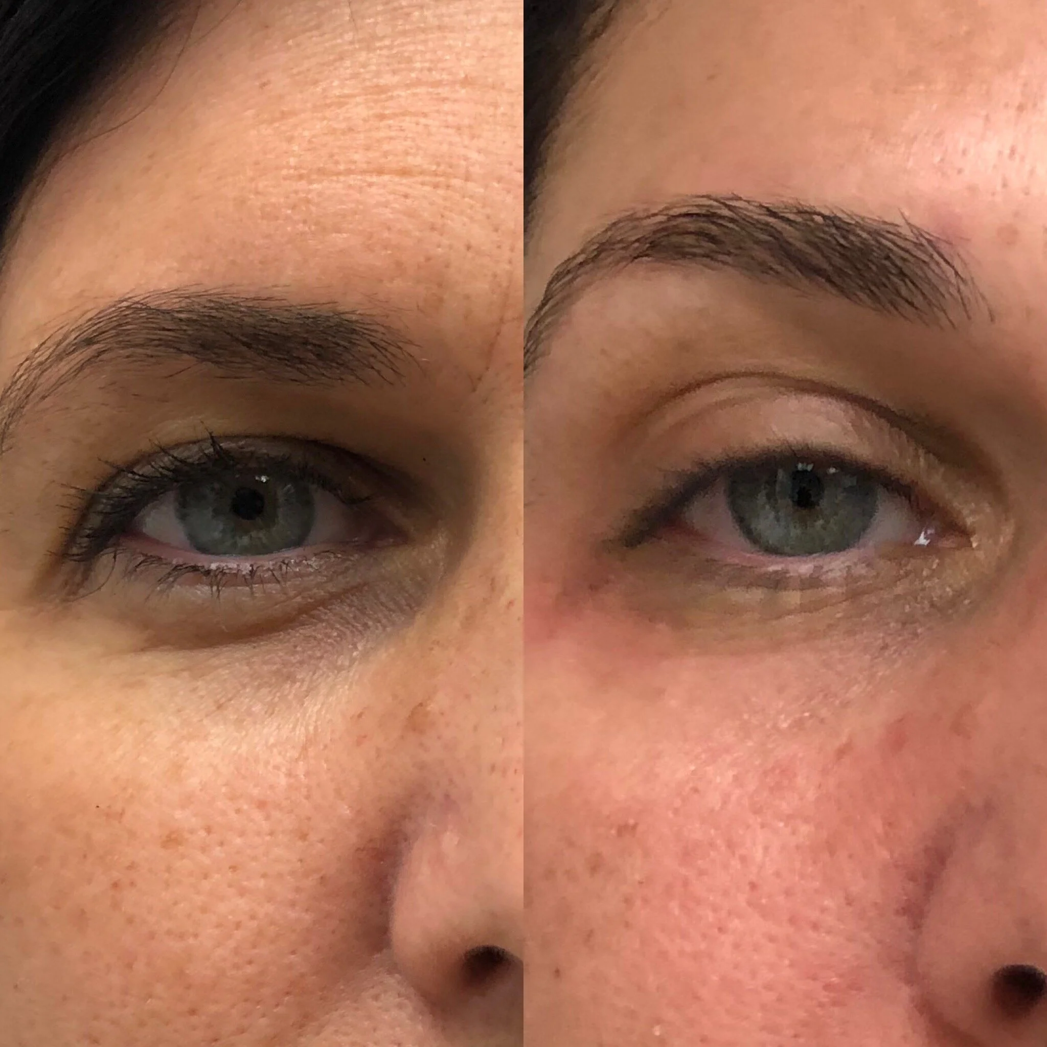 Before & Afters — Beverly Botox Nurse