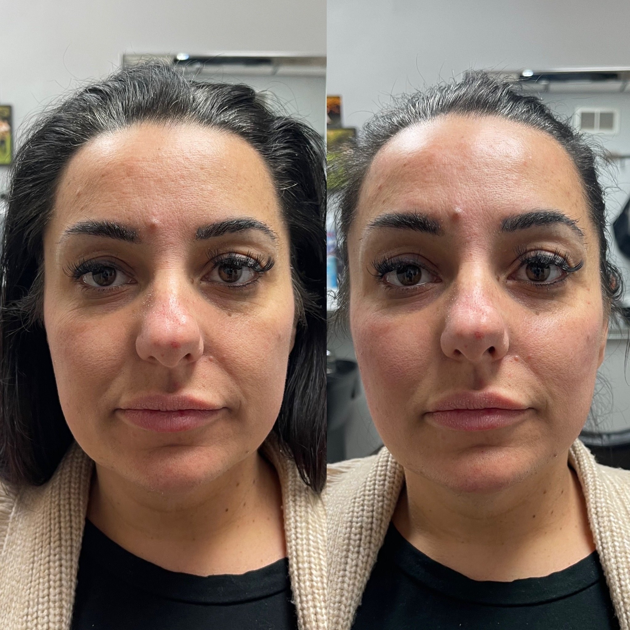 Before & Afters — Beverly Botox Nurse