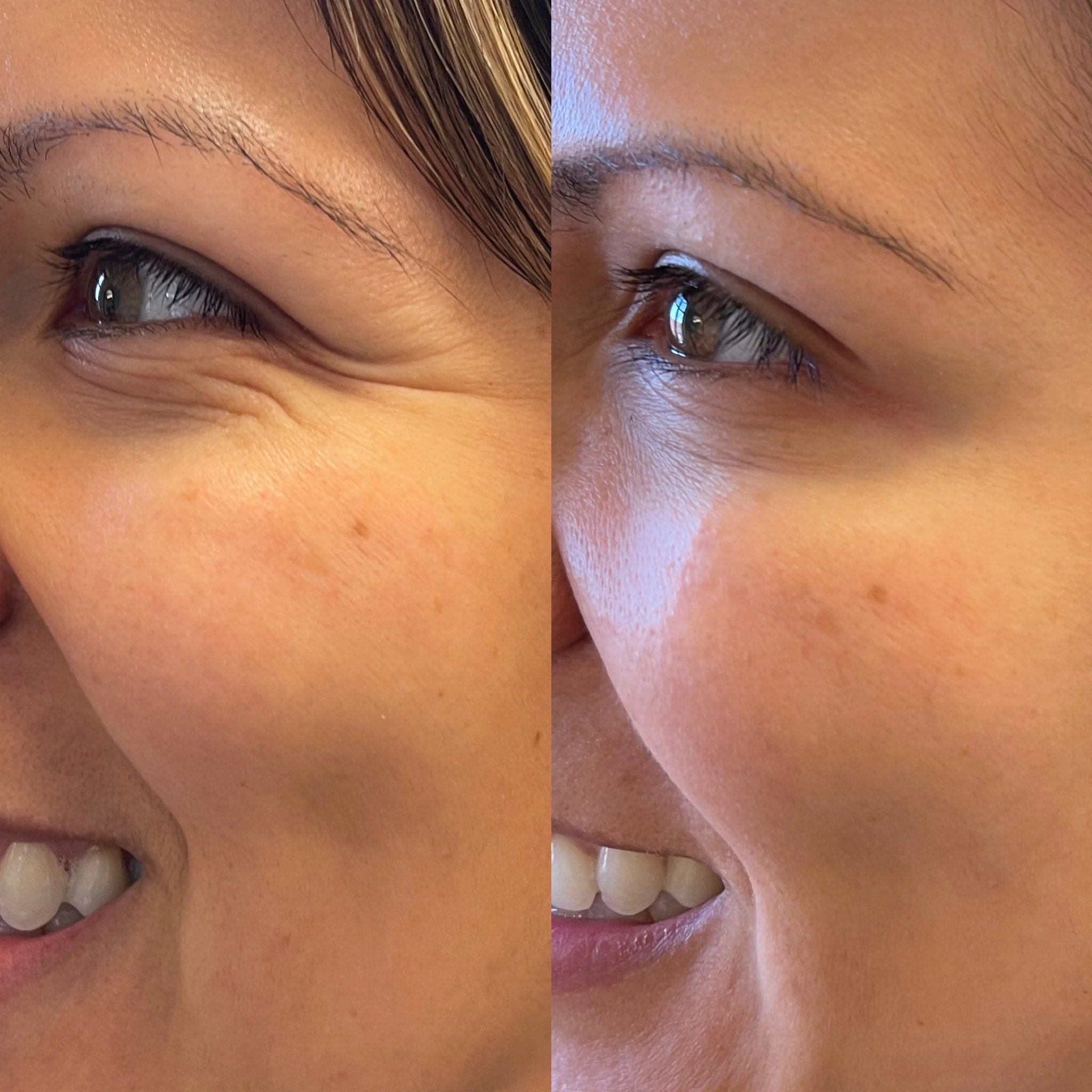 Before & Afters — Beverly Botox Nurse