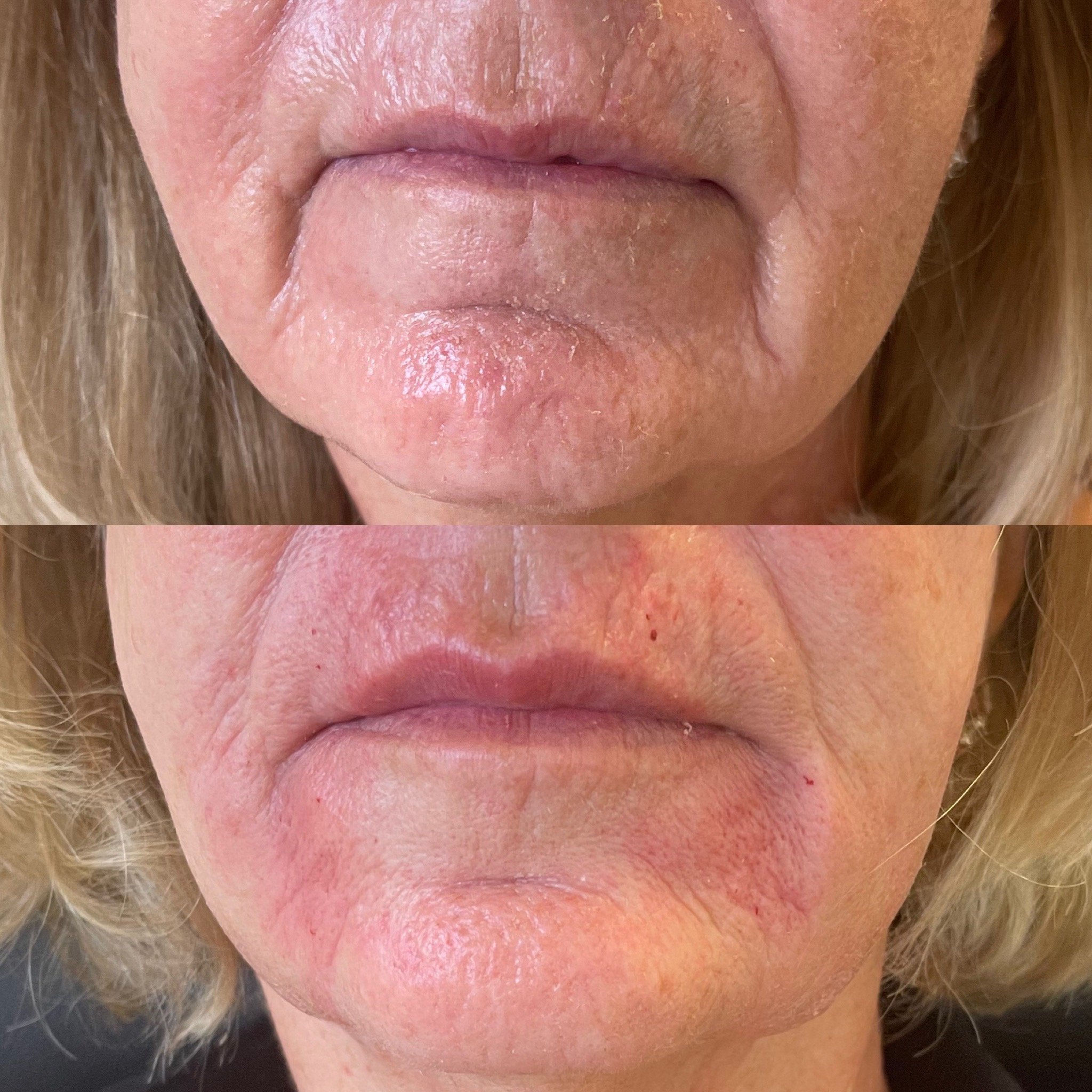 Before & Afters — Beverly Botox Nurse