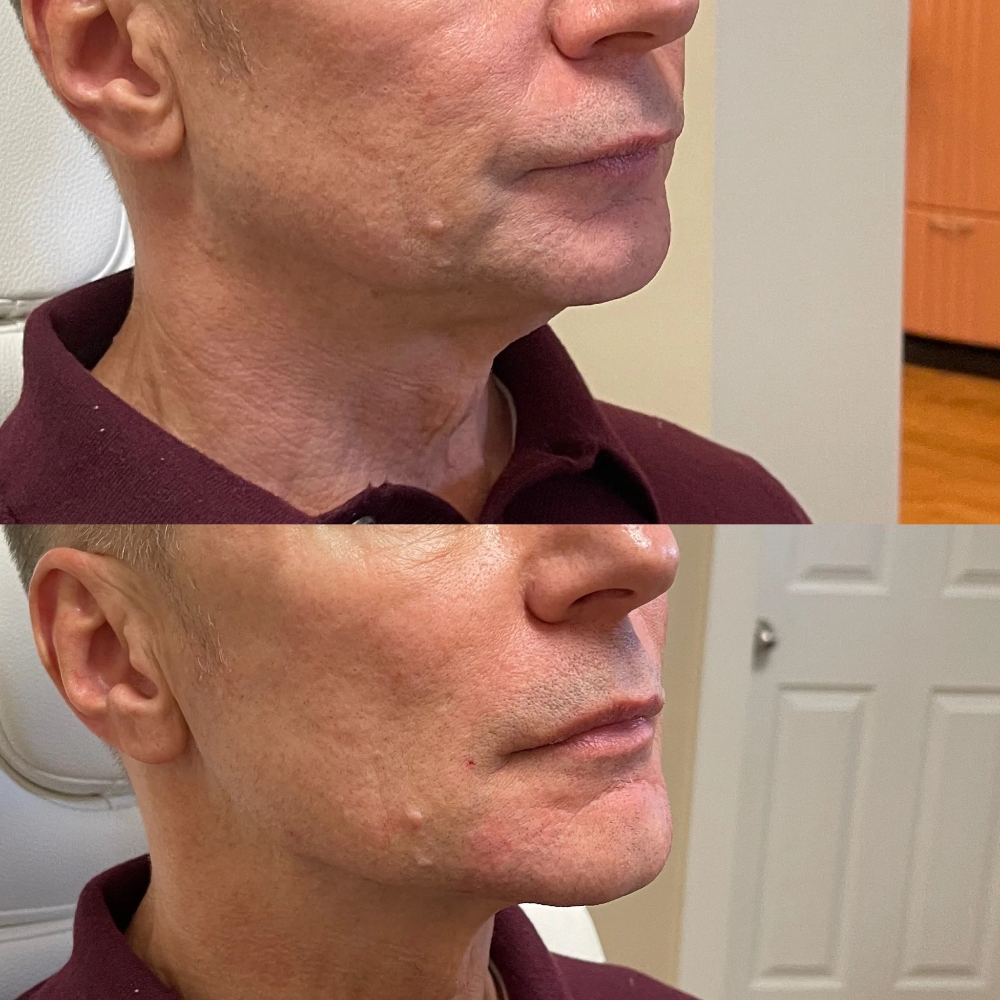 Before & Afters — Beverly Botox Nurse