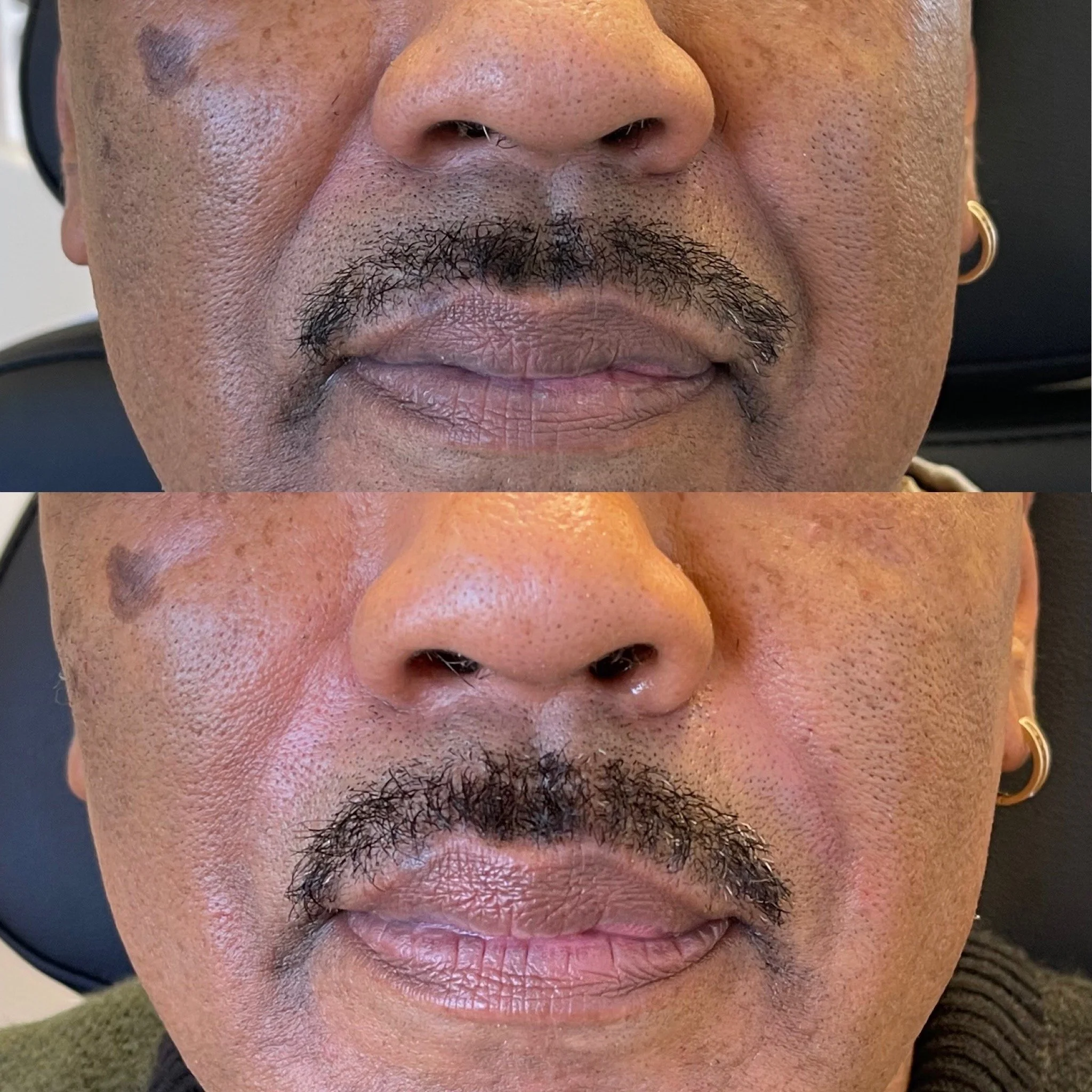 Before & Afters — Beverly Botox Nurse