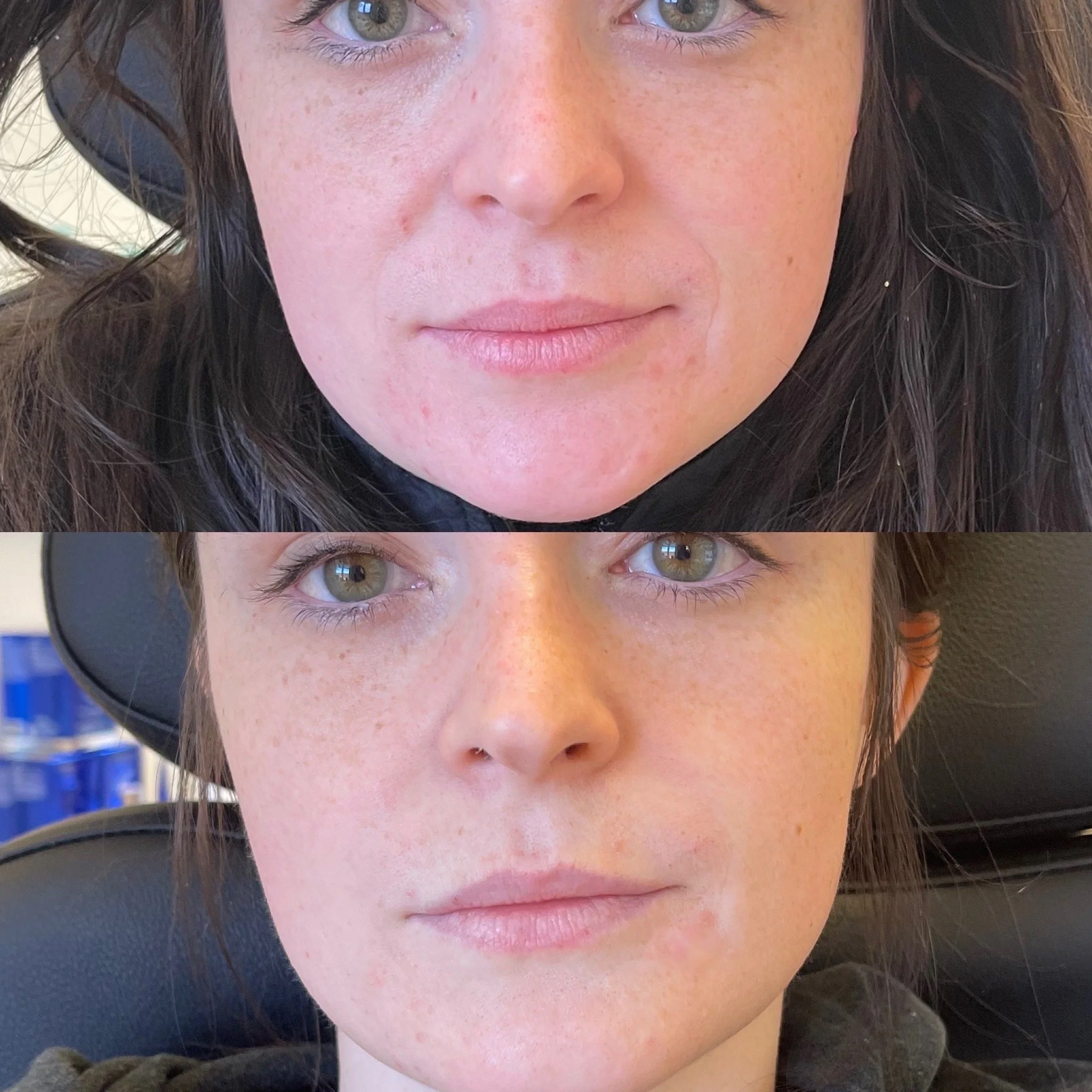 Before & Afters — Beverly Botox Nurse