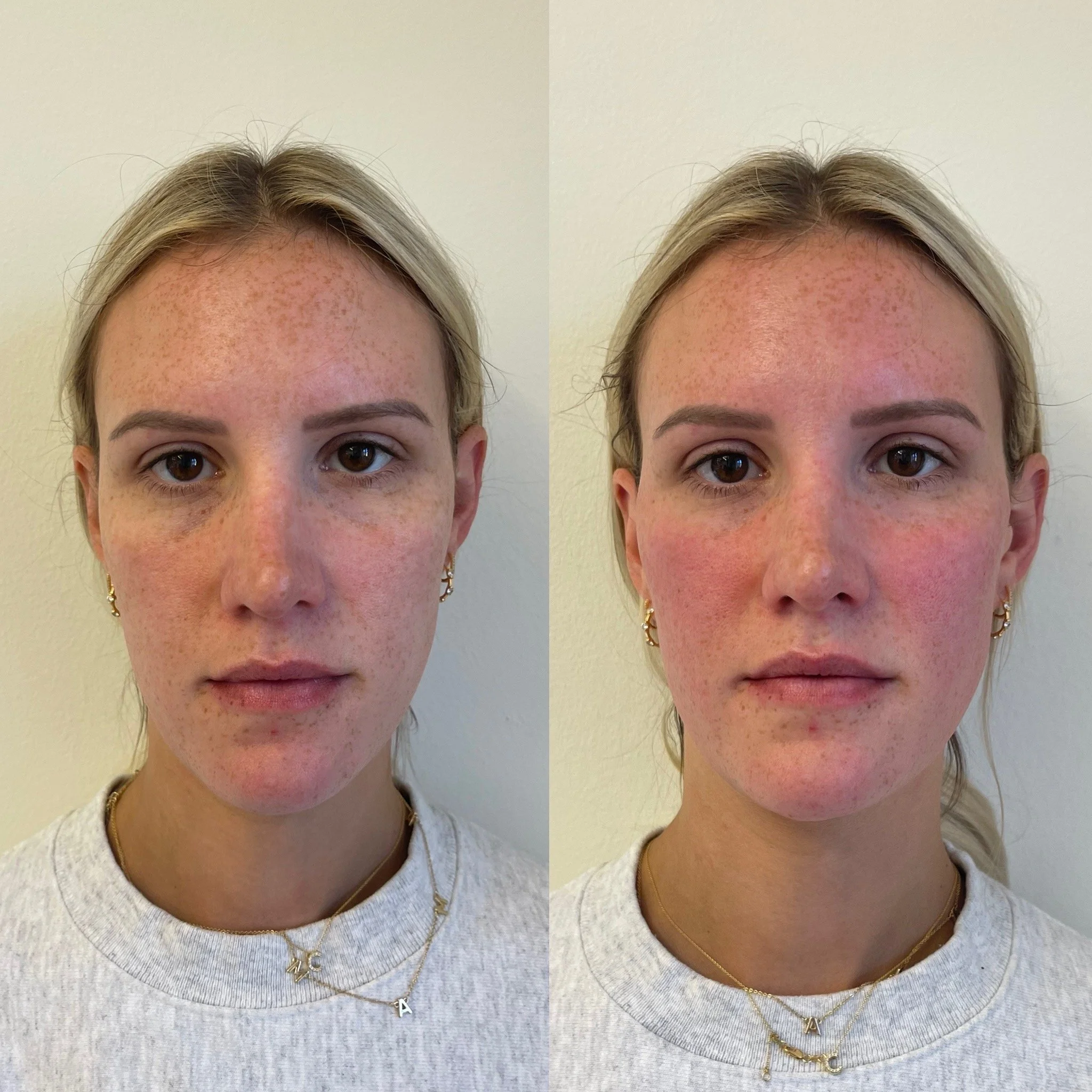 Before & Afters — Beverly Botox Nurse