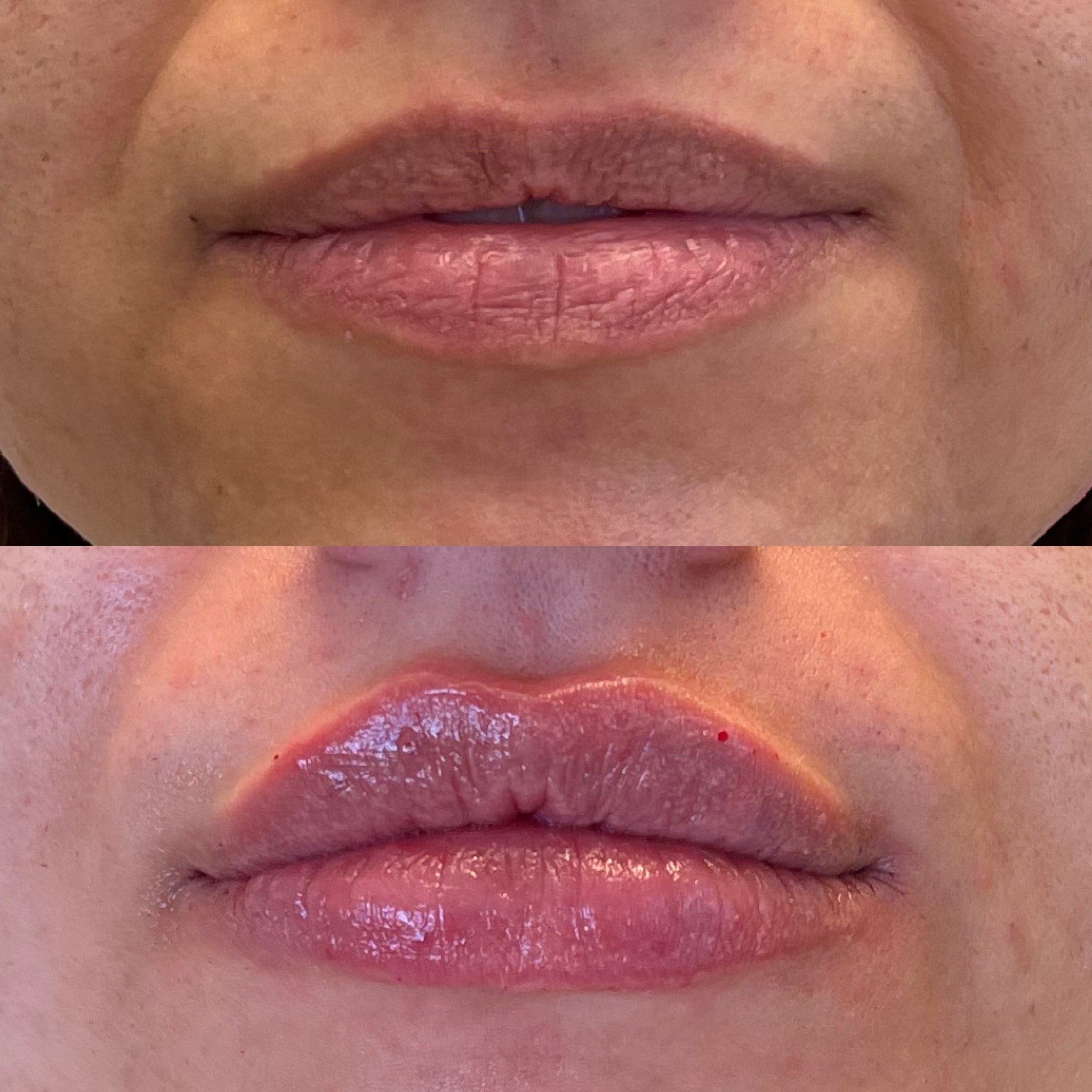 Before & Afters — Beverly Botox Nurse