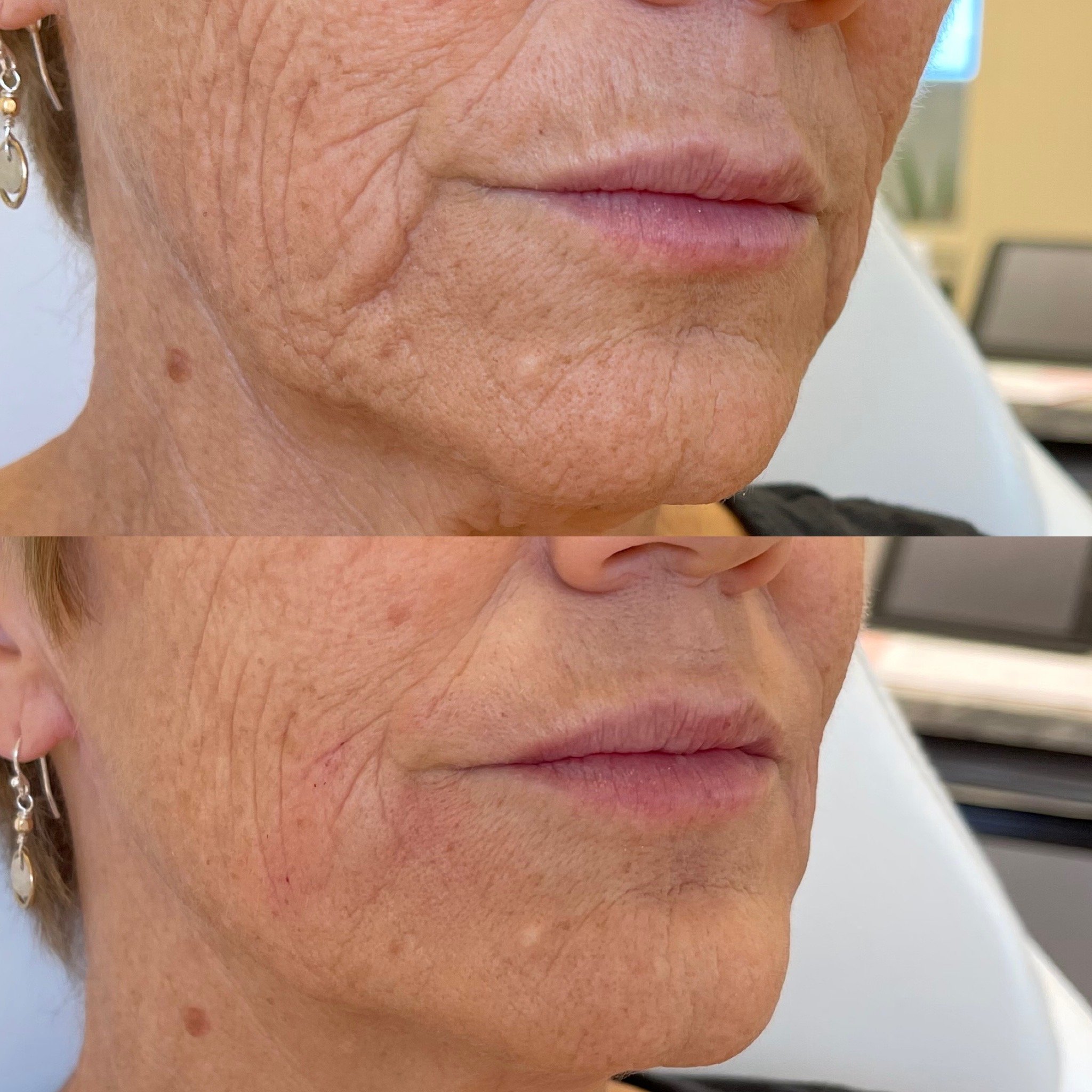 Before & Afters — Beverly Botox Nurse