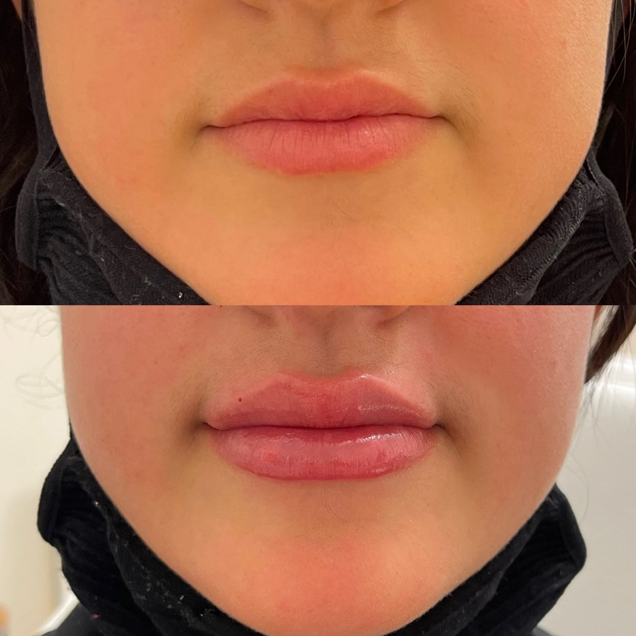 Before & Afters — Beverly Botox Nurse