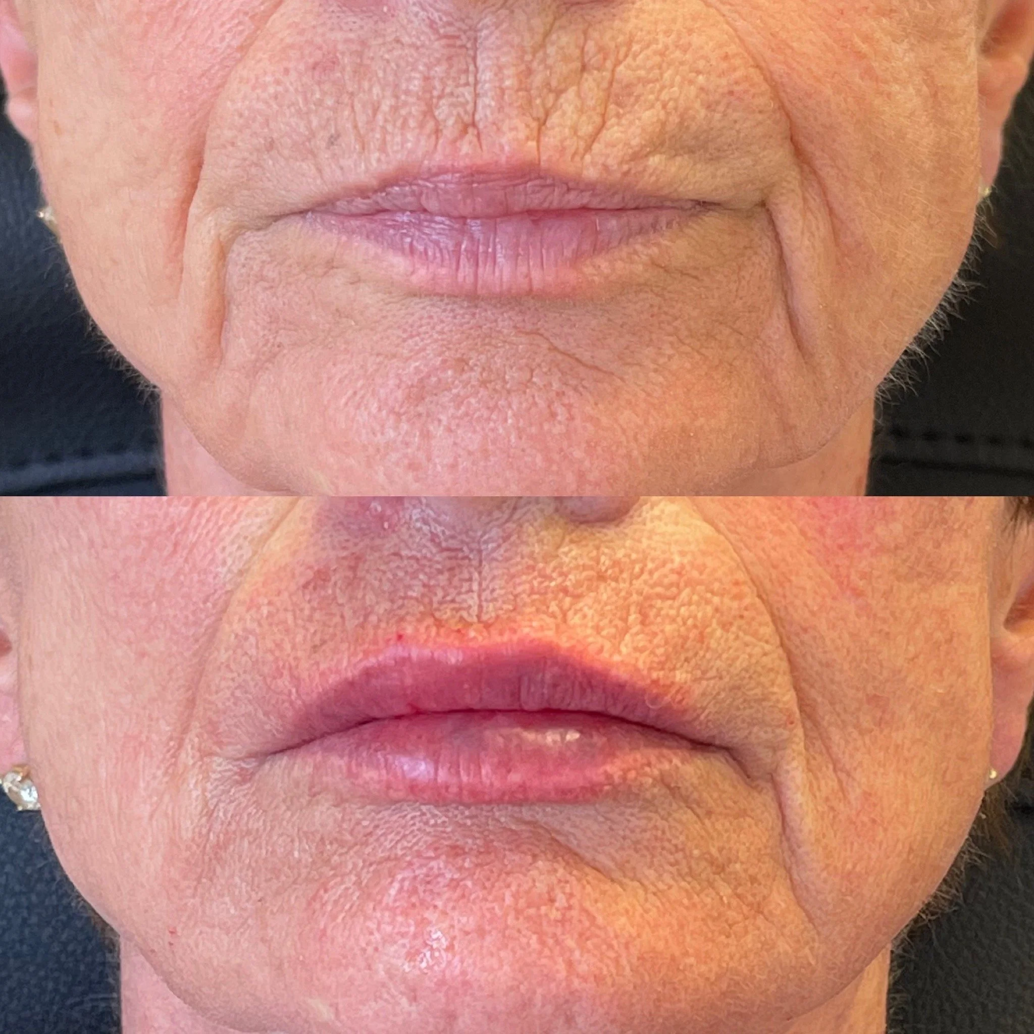 Before & Afters — Beverly Botox Nurse