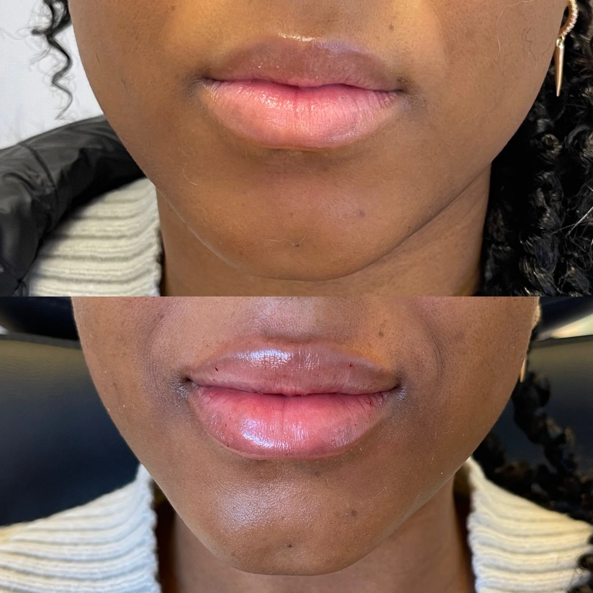 Before & Afters — Beverly Botox Nurse