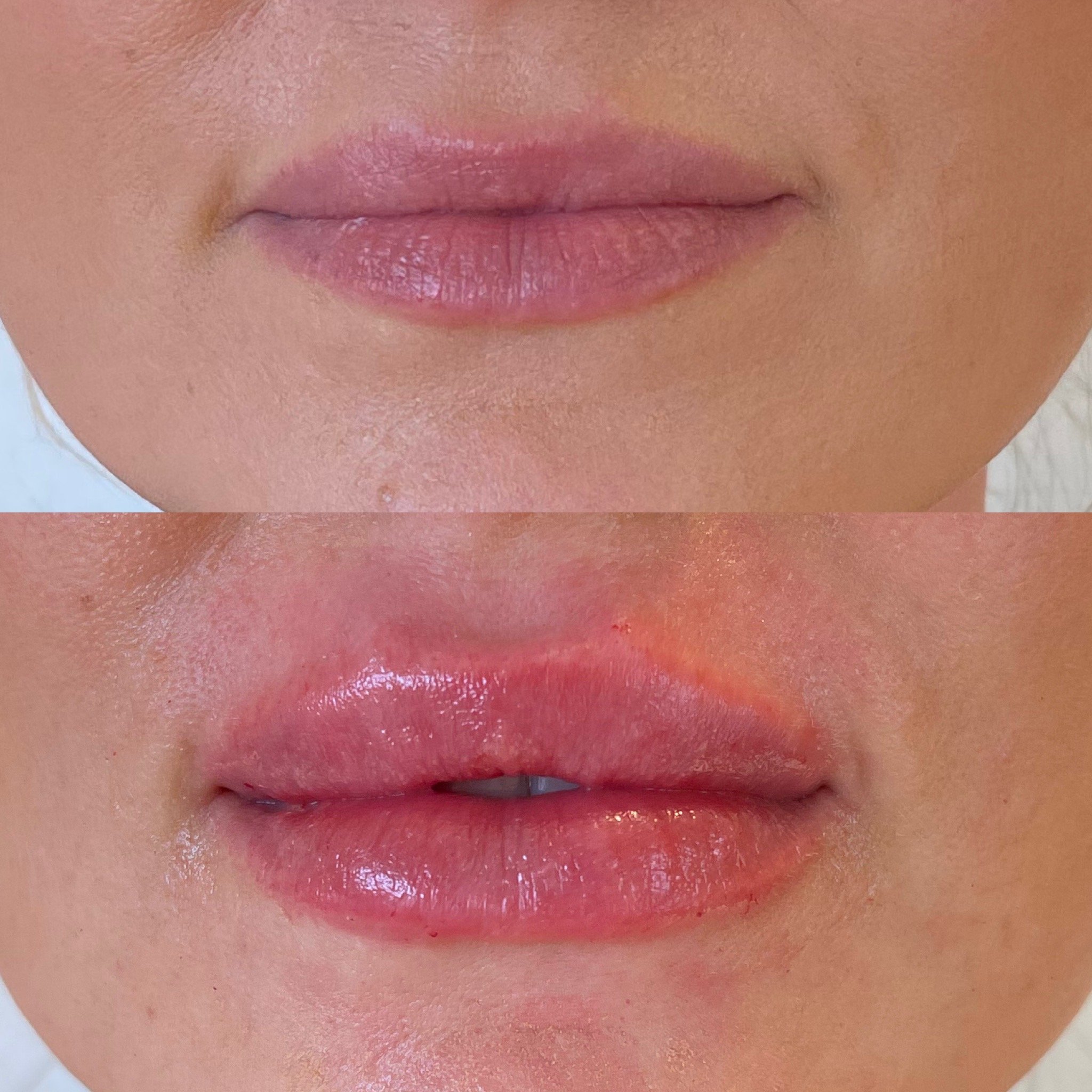 Before & Afters — Beverly Botox Nurse