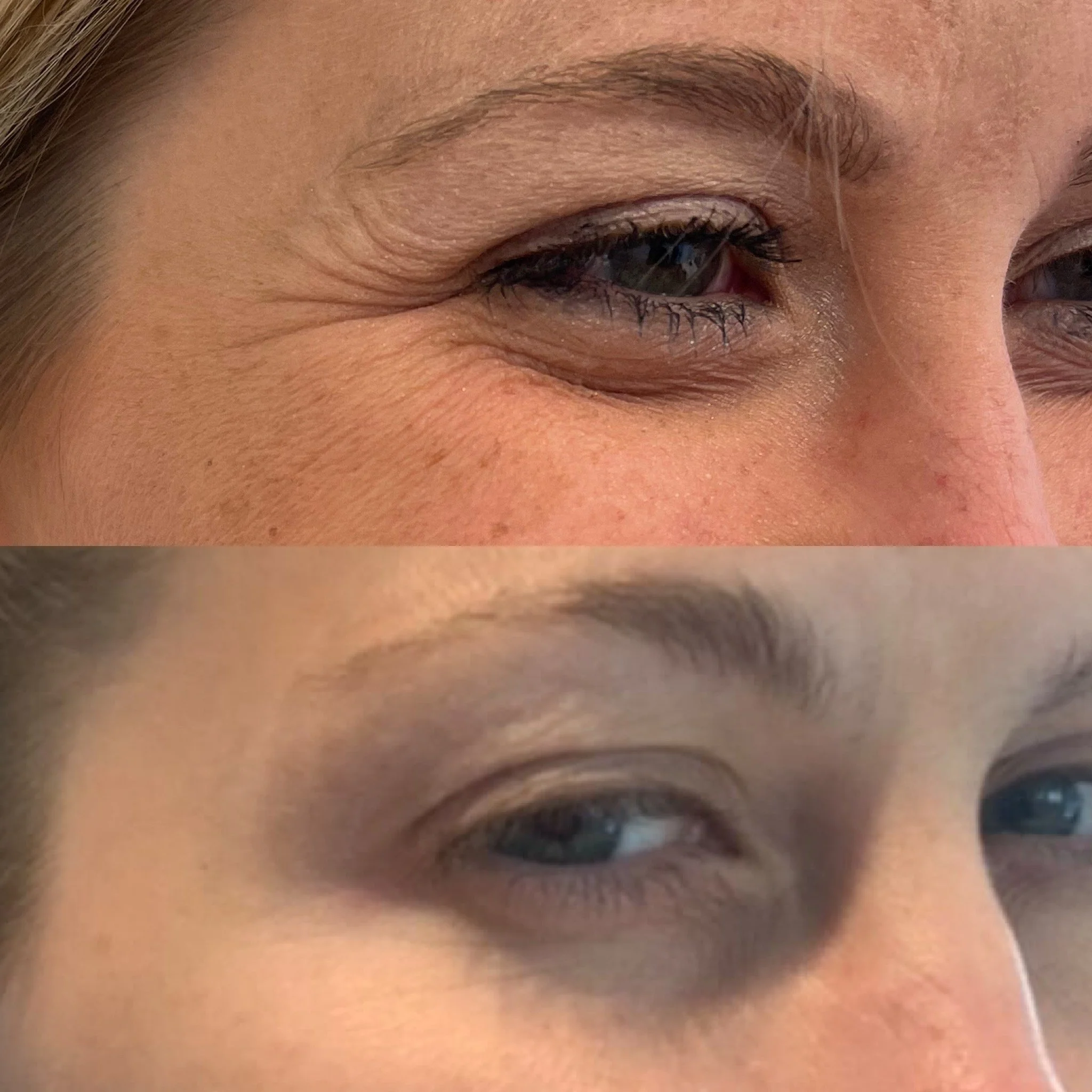 Before & Afters — Beverly Botox Nurse